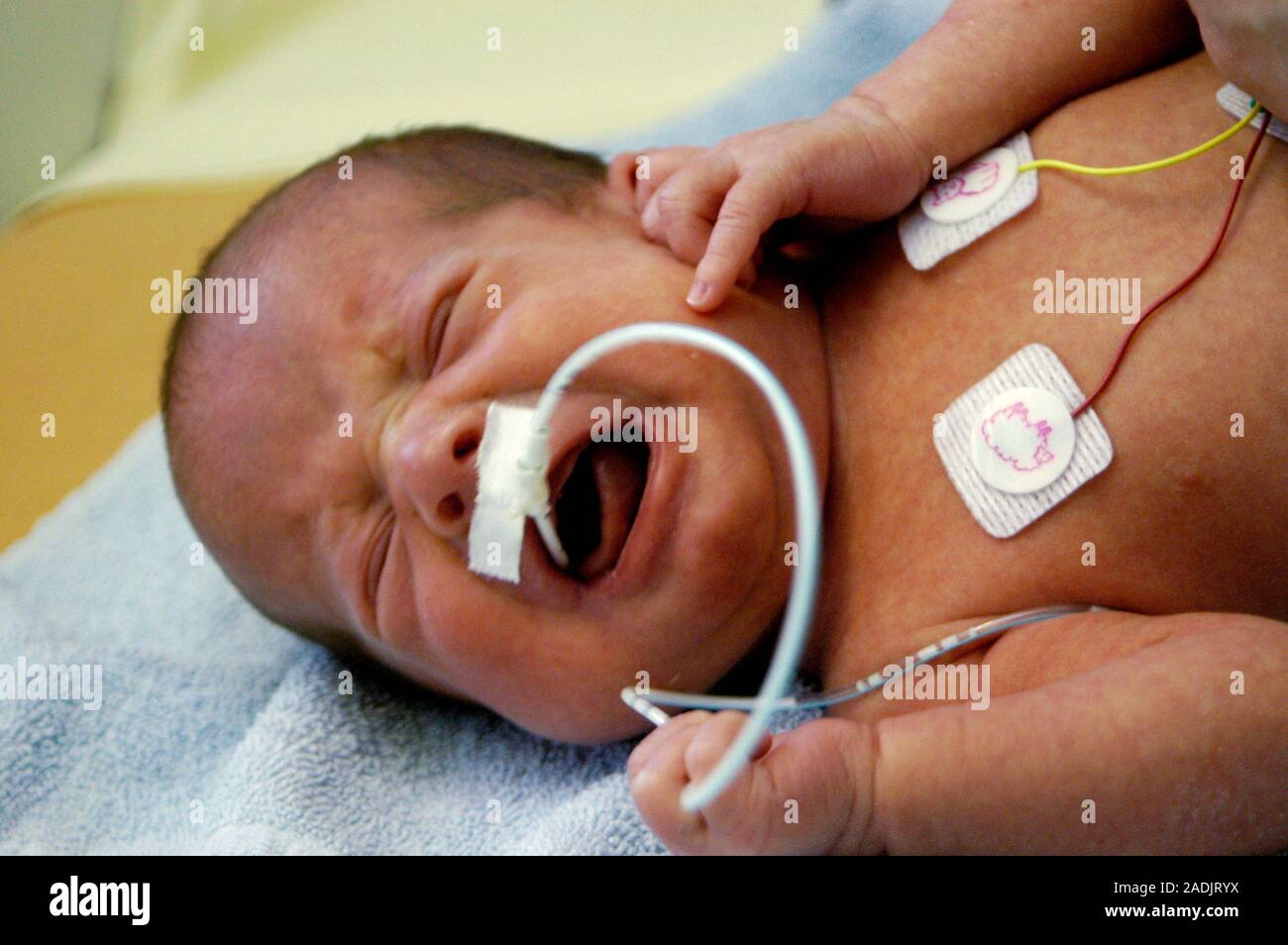 MODEL RELEASED. Premature baby crying. The electrocardiogram (ECG ...