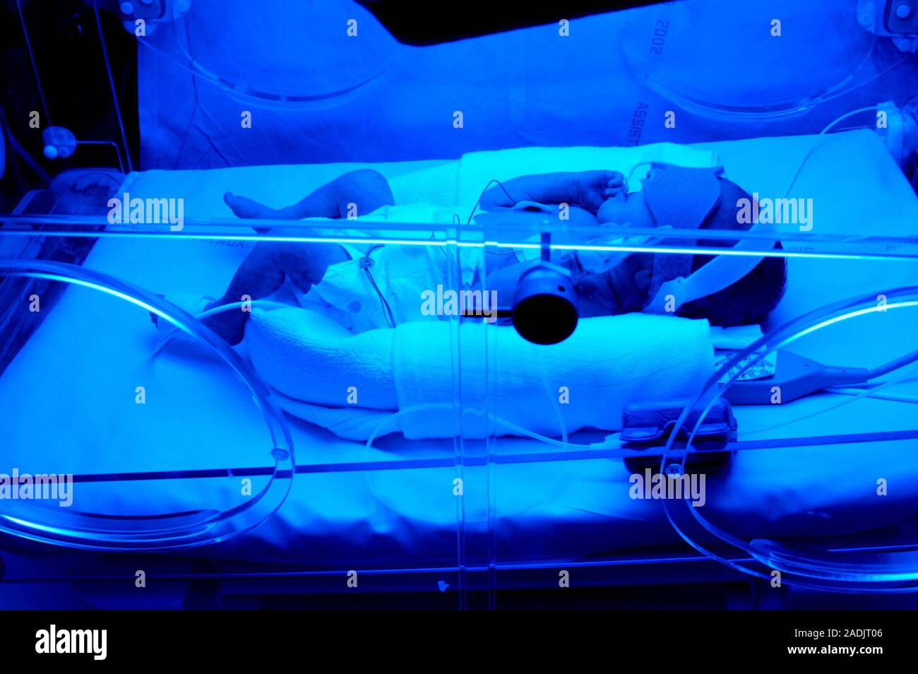Phototherapy. Premature baby in an incubator receiving phototherapy to ...