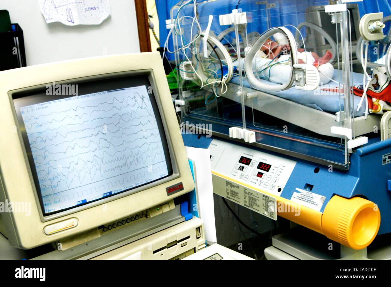 EEG examination. Premature baby undergoing an electroencephalograph ...