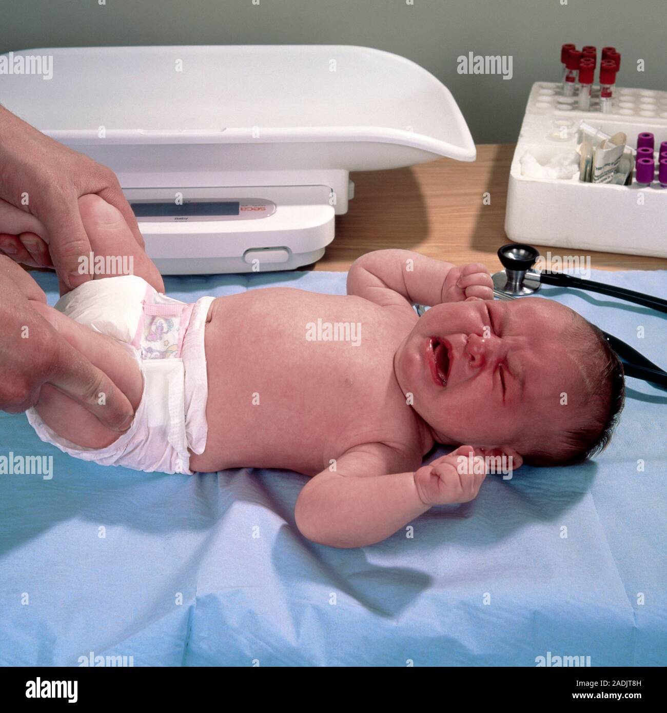 Hip dislocation test. A 6-week-old baby girl is examined for signs of ...