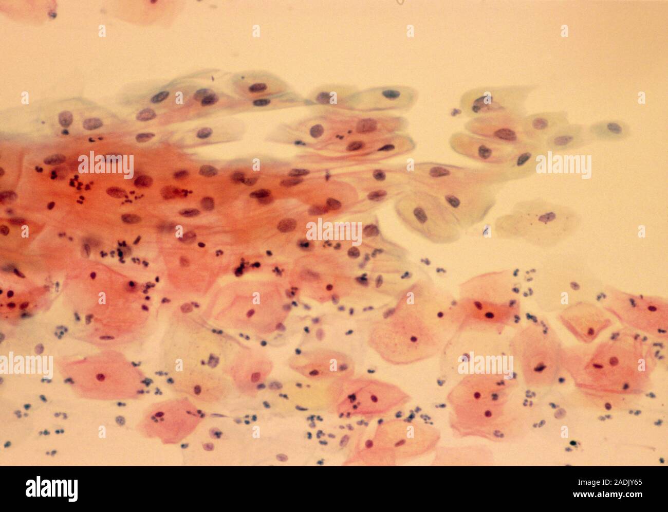Light micrograph of a cervical smear, showing mild dysplasia (graded ...