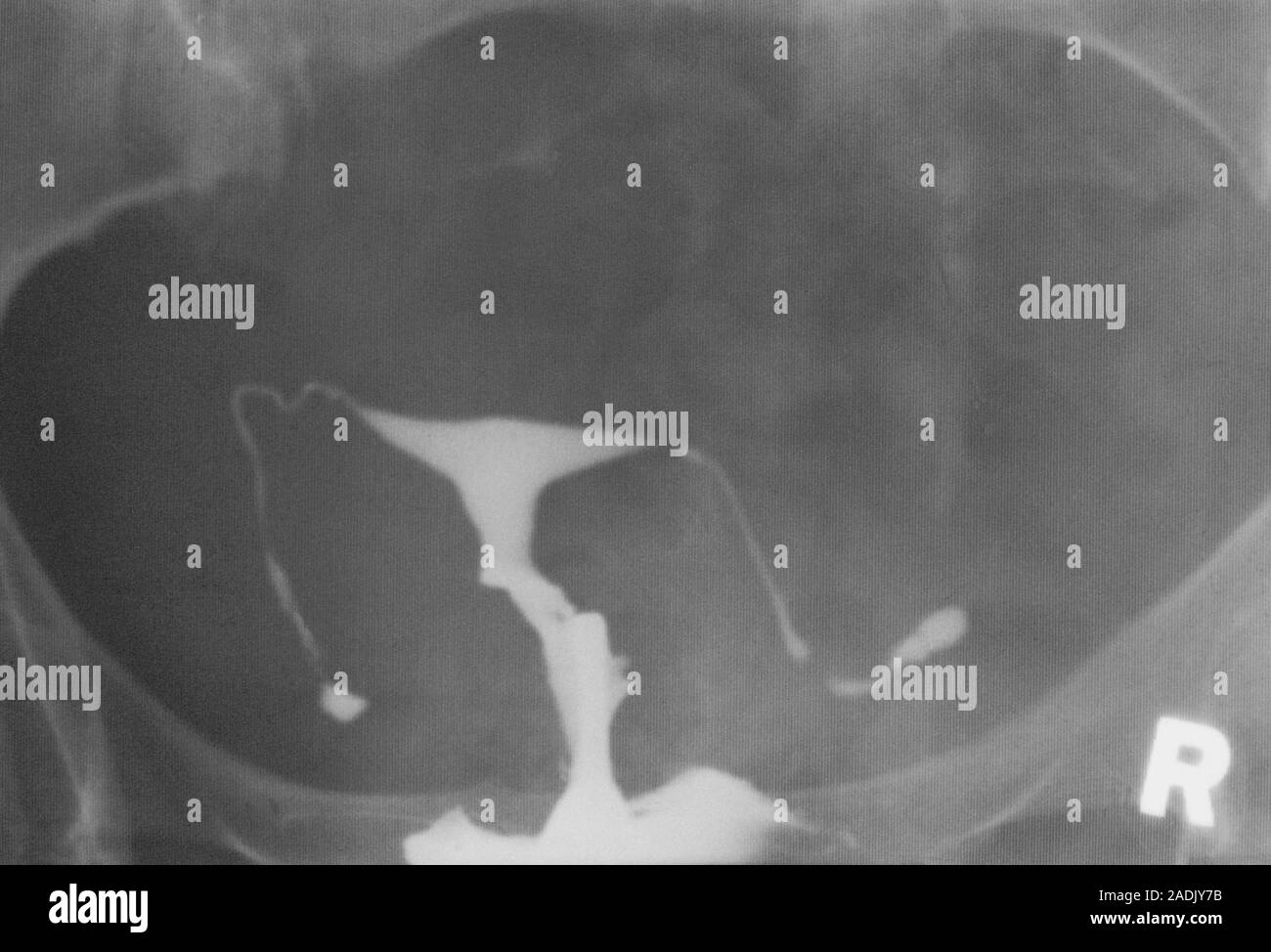 X-ray image of blocked fallopian tubes, especially the tube on the ...
