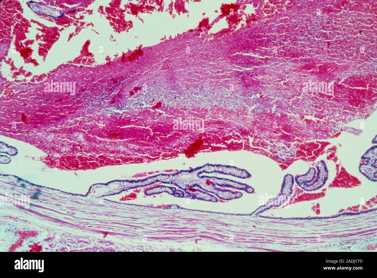 Light micrograph of a human fallopian tube showing a tubal ectopic ...