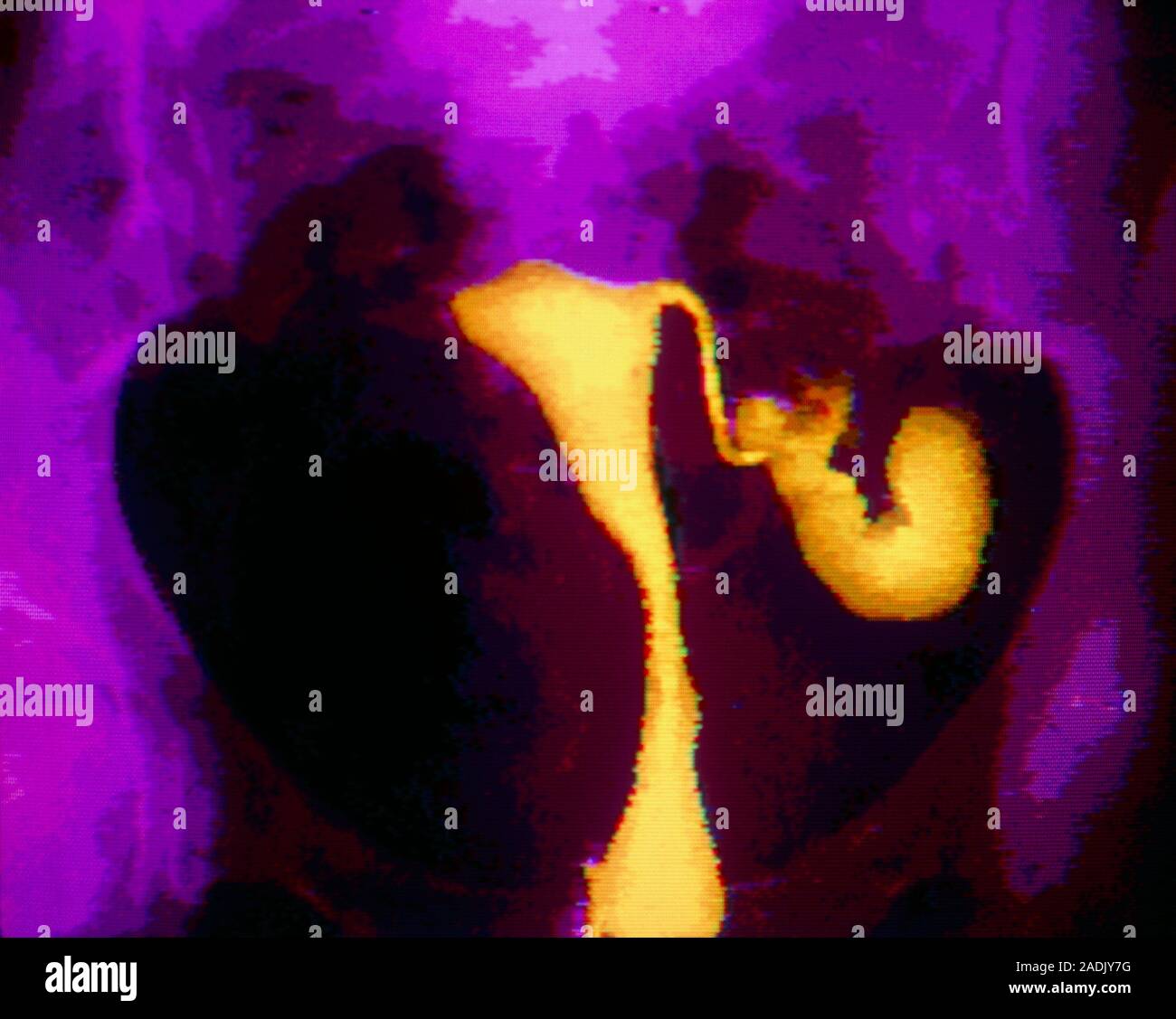 Infertility: false-colour hysterosalpingogram of the abdomen of a woman ...