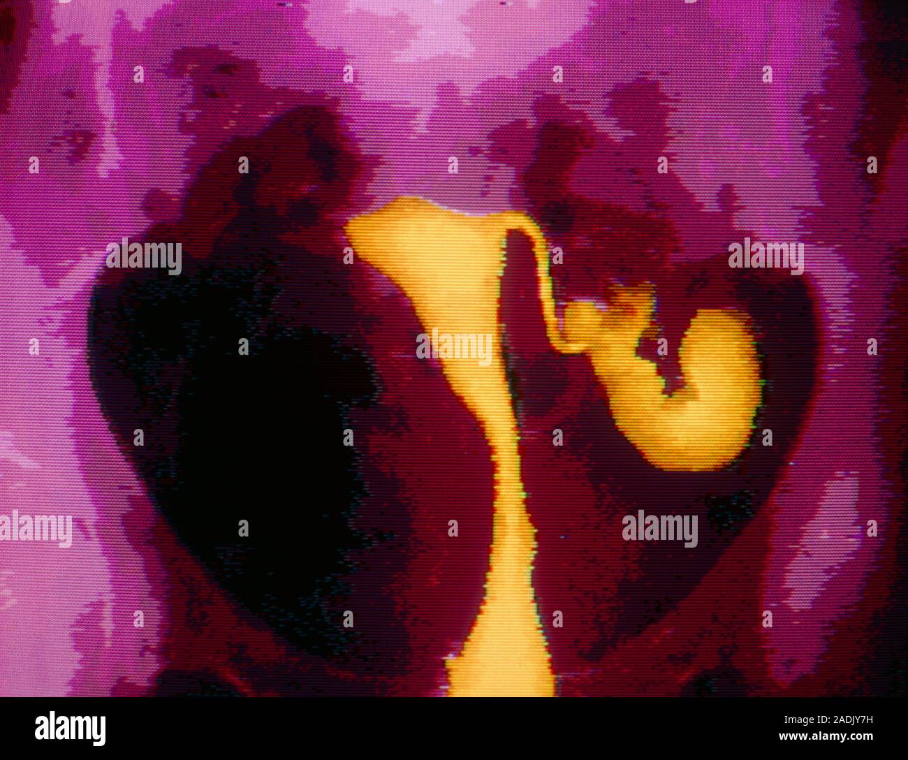 Infertility: false-colour hysterosalpingogram of the abdomen of a woman ...