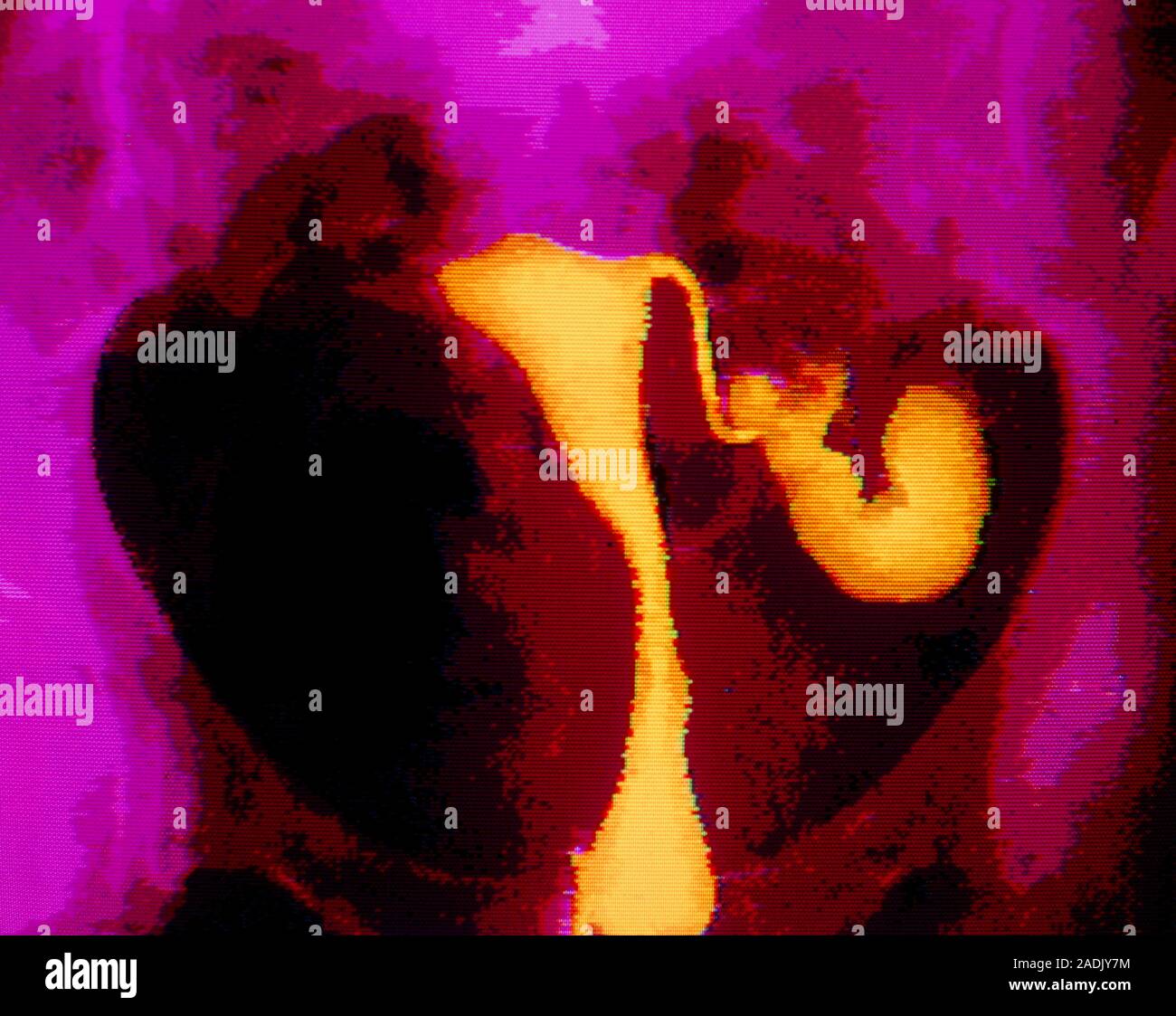 Infertility: false-colour hysterosalpingogram of the abdomen of a woman ...