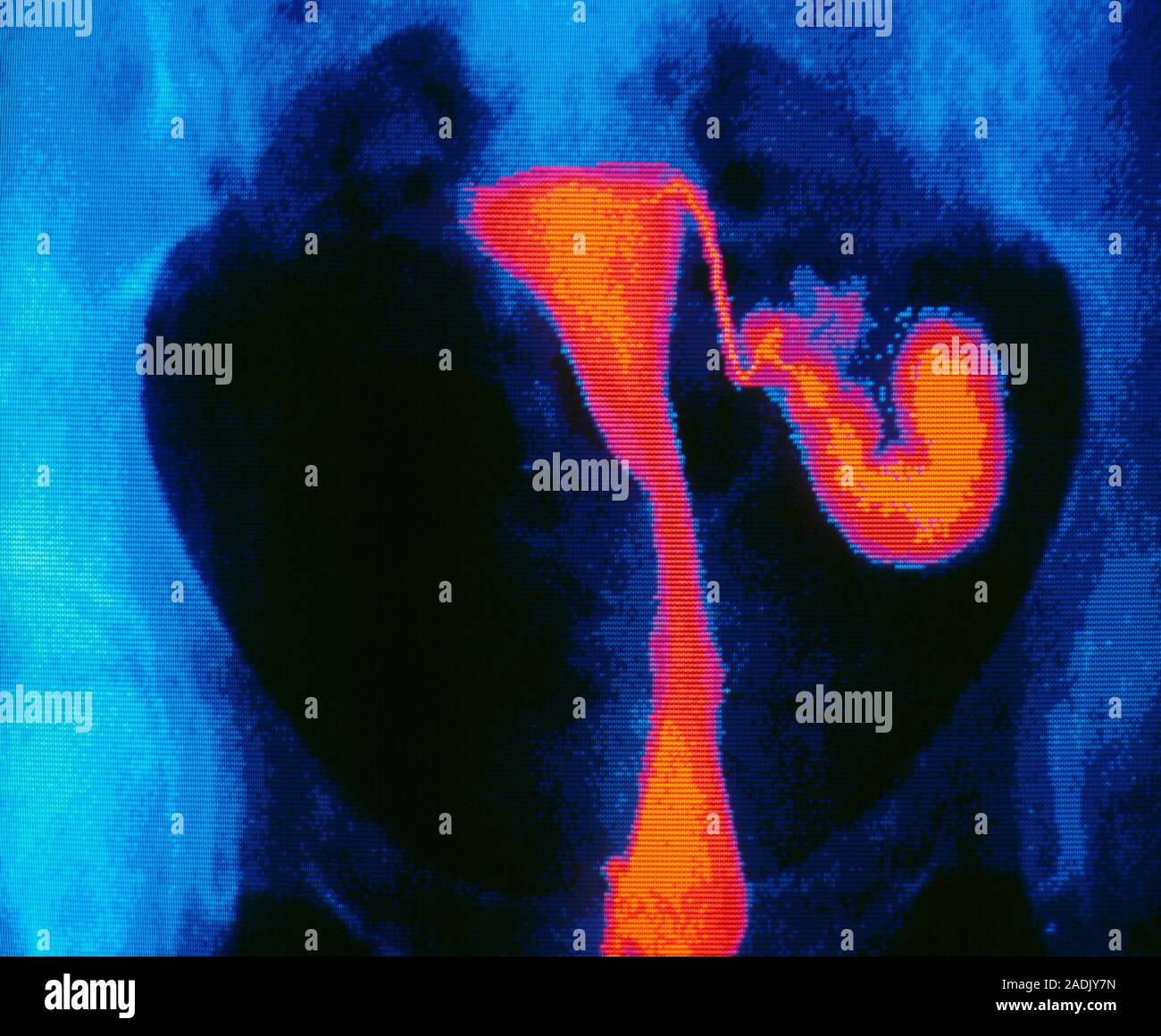 Infertility: false-colour hysterosalpingogram of the abdomen of a woman ...