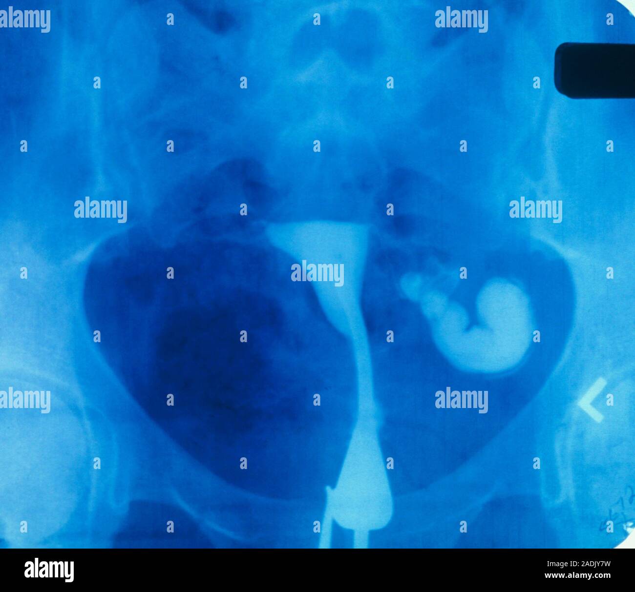 Infertility: hysterosalpingogram of the abdomen of a woman suffering ...