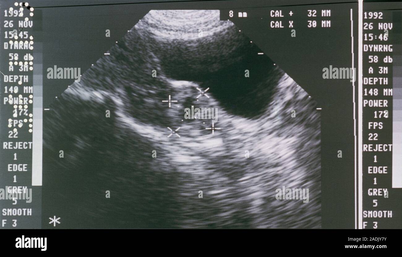 Ultrasound image showing an ectopic pregnancy occurring in the right ...