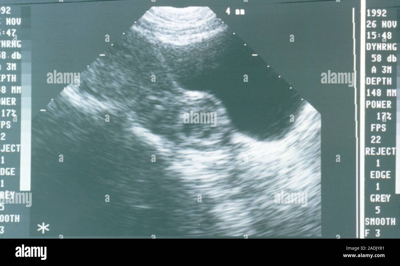 Ultrasound image showing an ectopic pregnancy occurring in the right ...