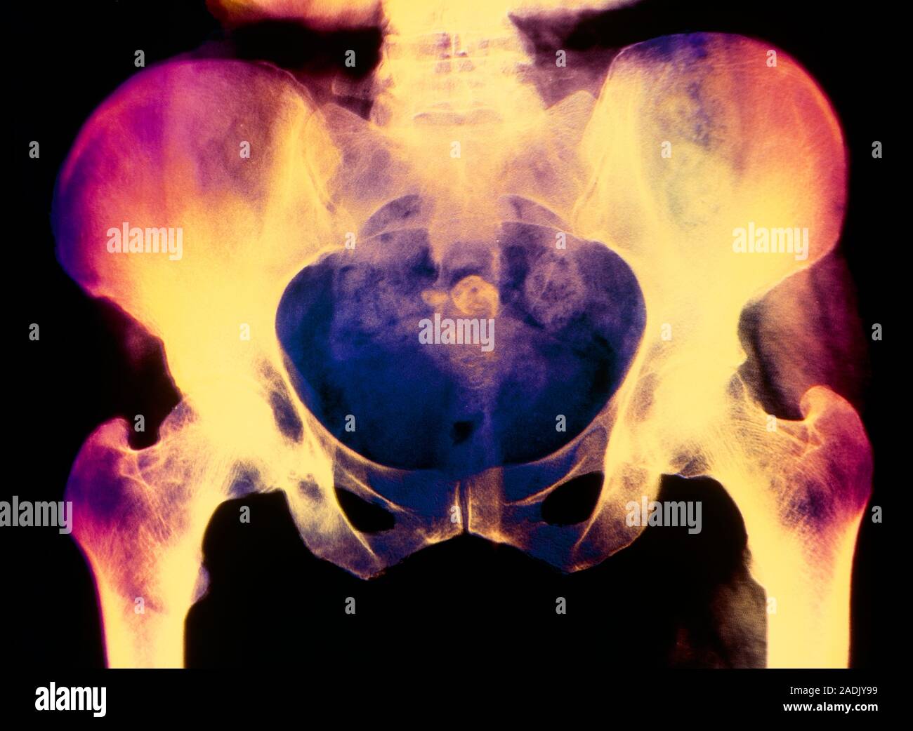 Coloured X-ray showing a calcified fibroid, a benign tumour of the ...