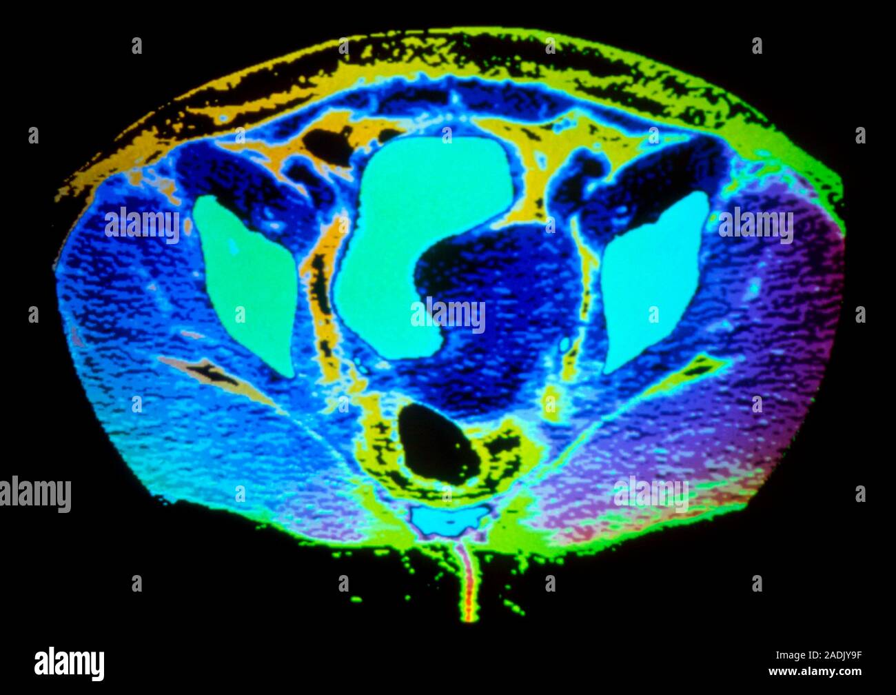 Fibroid of uterus. Coloured computed tomography (CT) scan showing a ... Fibroid of uterus. Coloured computed tomography (CT) scan showing a ...