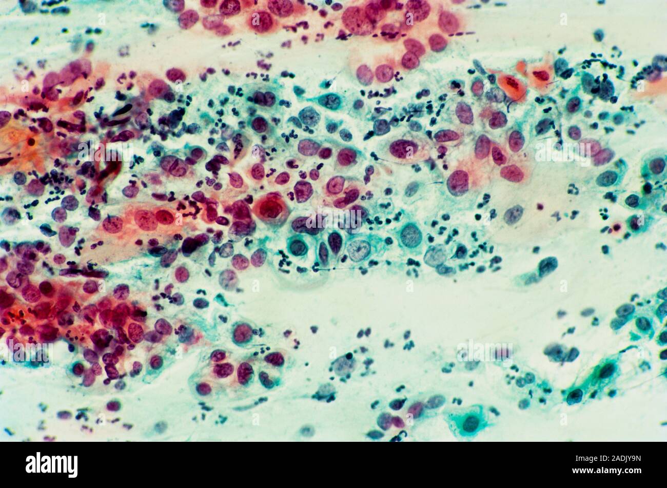 Severe dysplasia of cervix. Light micrograph of a cervical smear ...