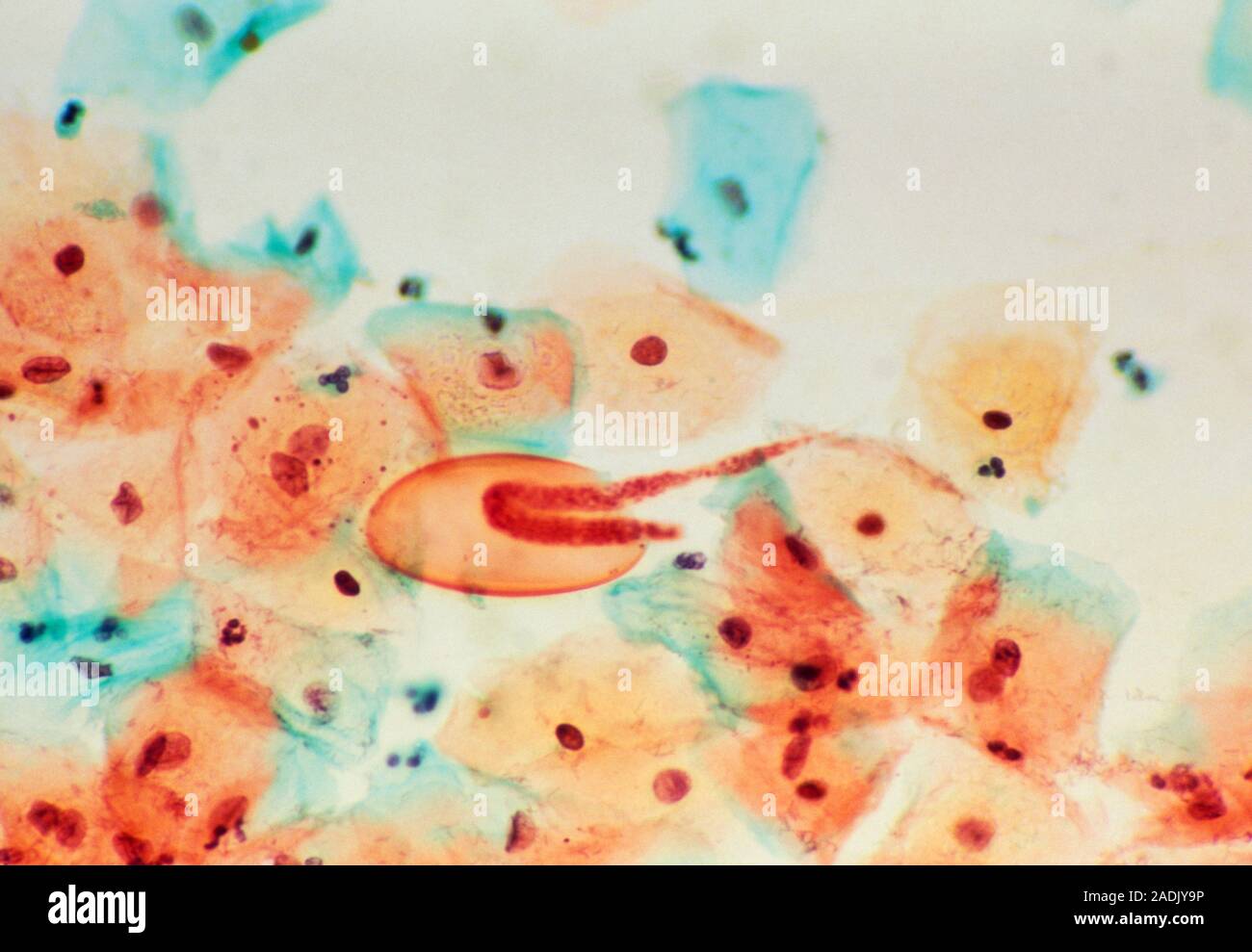 Threadworm in the cervix. Light micrograph of a cervical smear showing ...