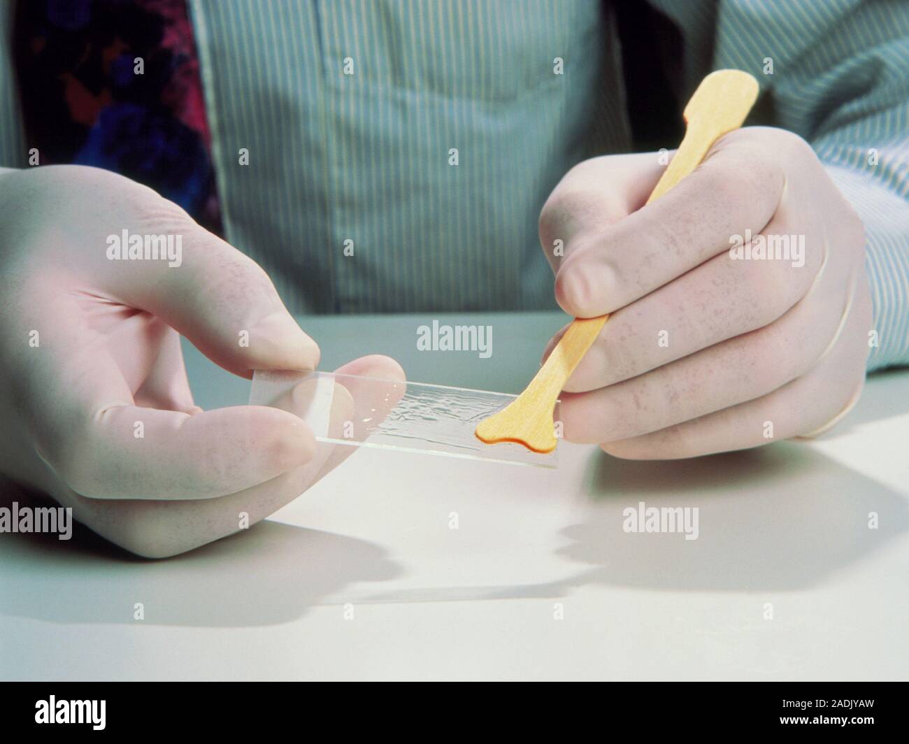 Cervical smear. Close-up of a cervical smear sam- ple being smeared ...