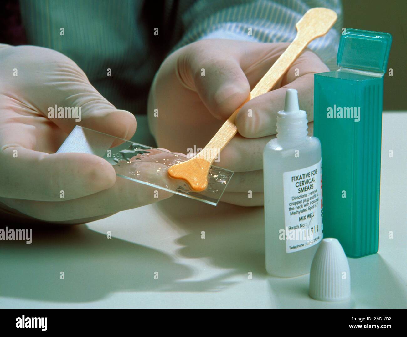 Cervical smear. Close-up of fixative being applied to a cervical smear ...