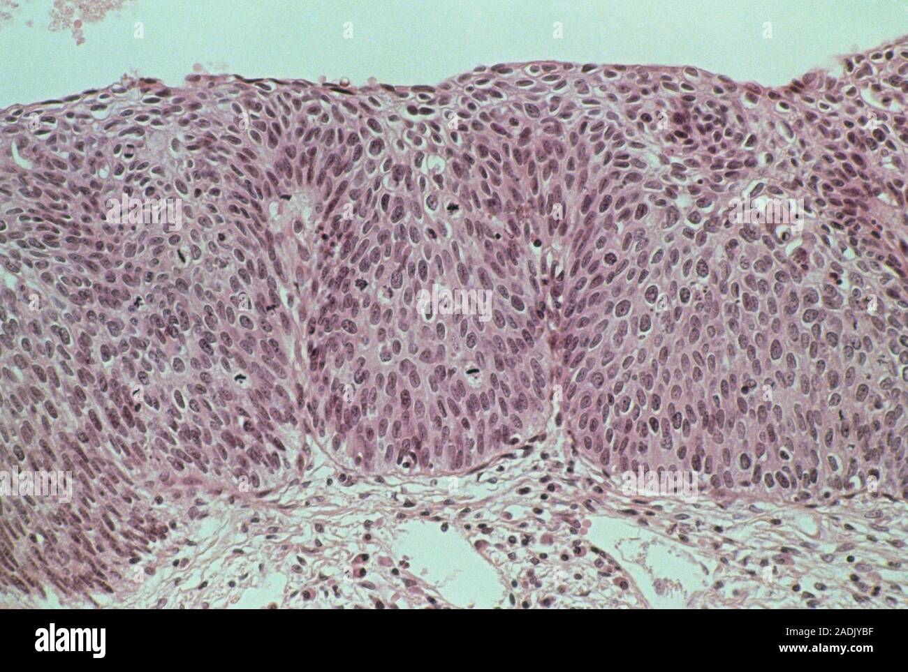 Cervical cancer. Light micrograph of a section through a carcinoma in ...