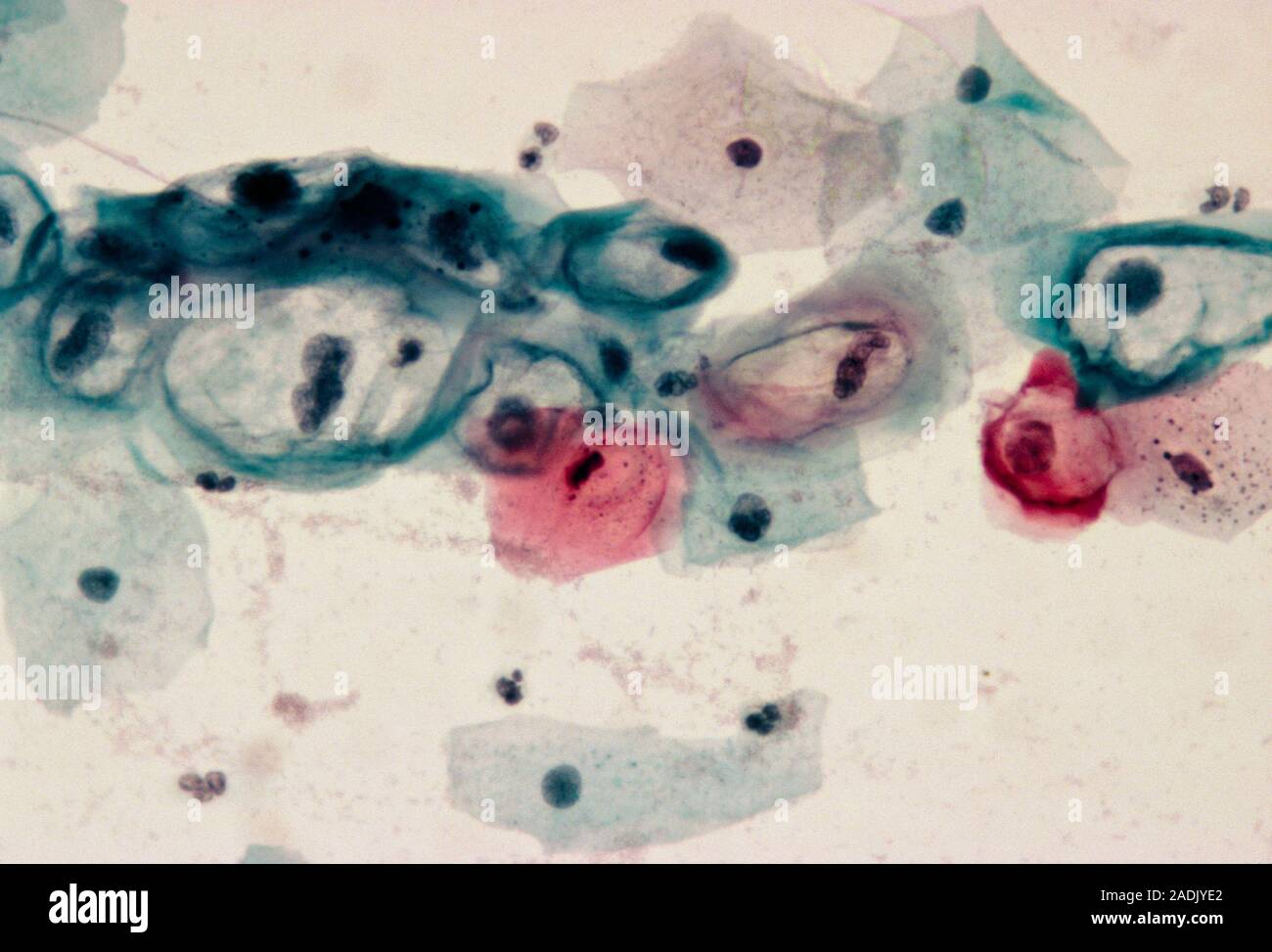 HPV cervical infection. Light micrograph of a cervical smear revealing ...
