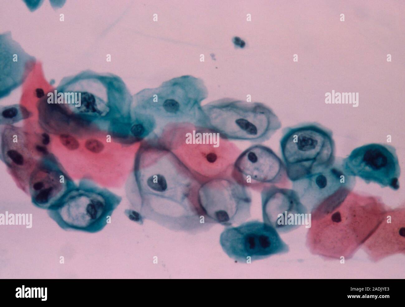 HPV cervical infection. Light micrograph of a cervical smear revealing ...