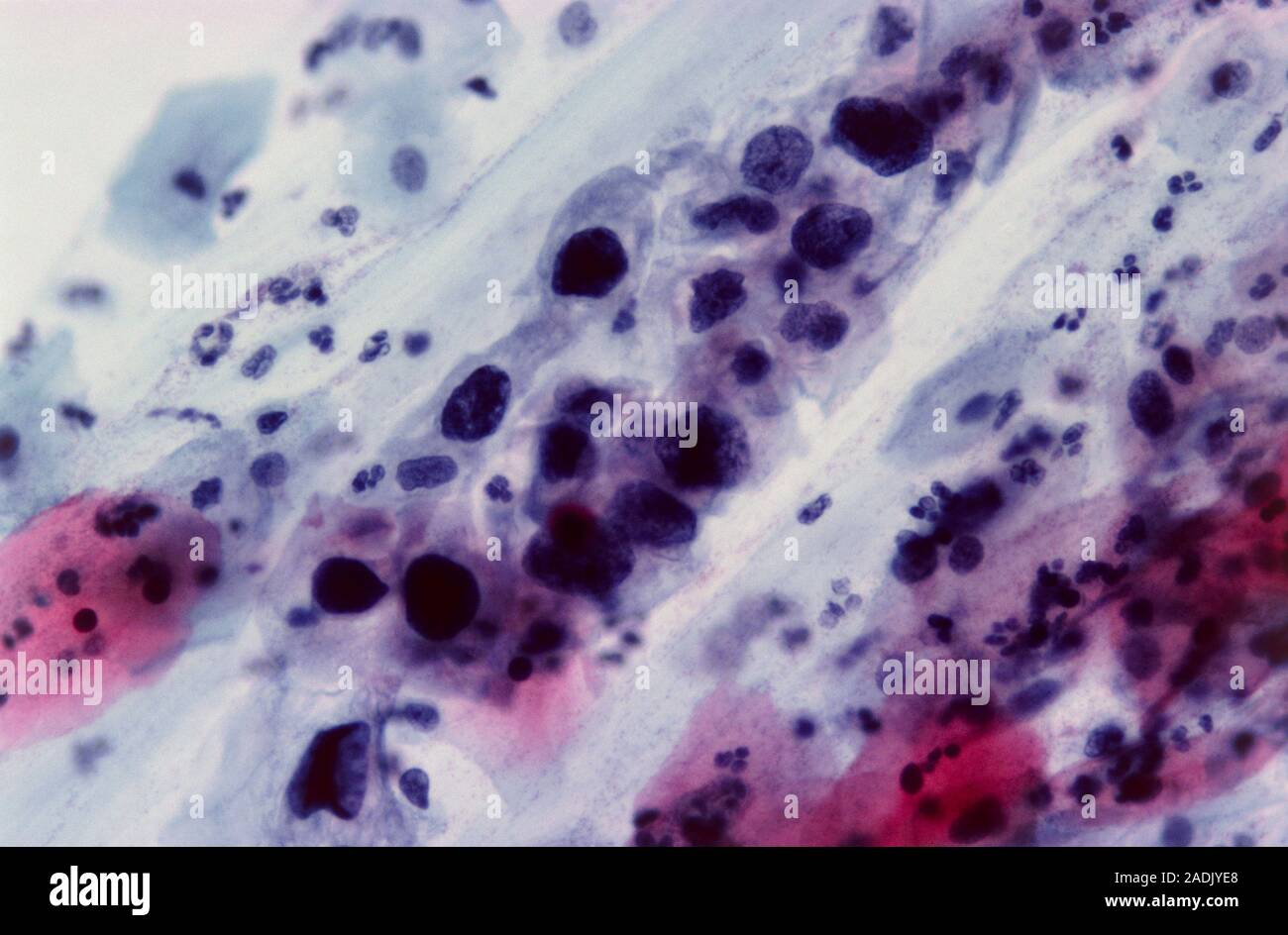 Severe dysplasia of cervix. Light micrograph of a cervical smear ...