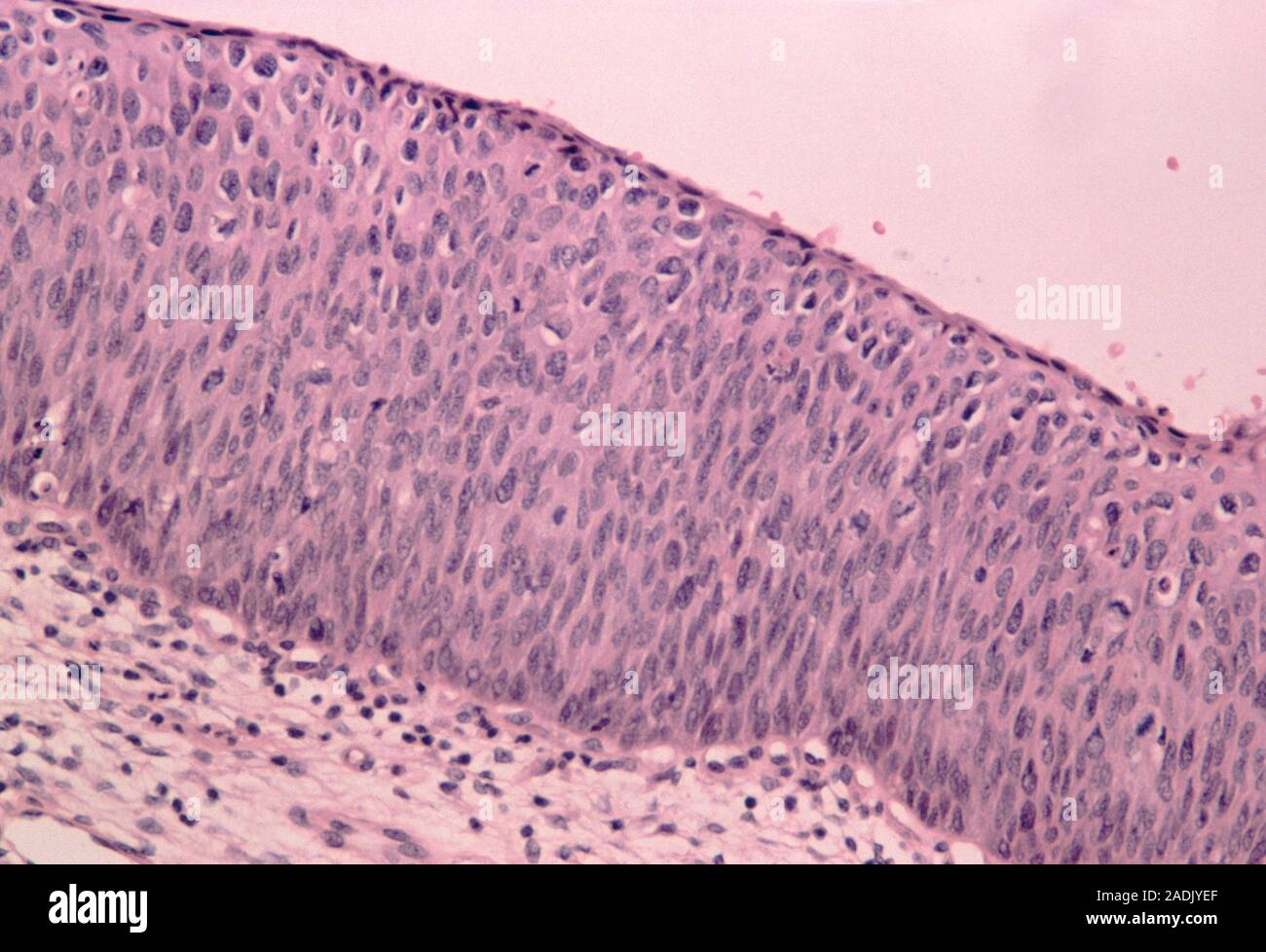 Severe cervical dysplasia. Light micrograph of a section through human ...