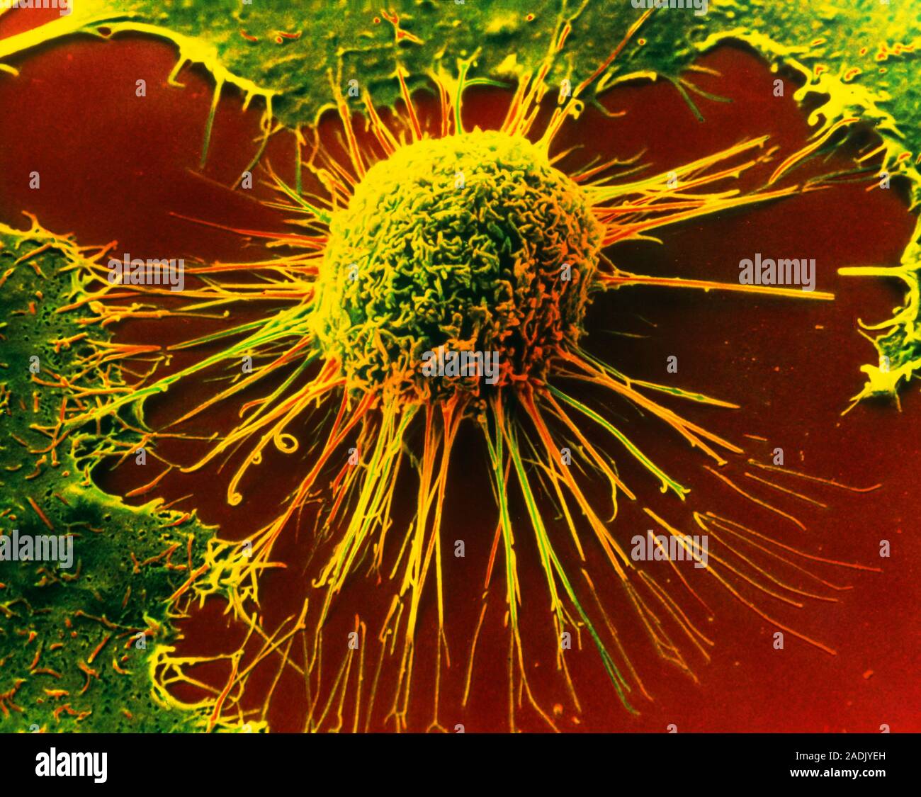 Cancer cell. Coloured scanning electron micrograph (SEM) of a cell of a ...