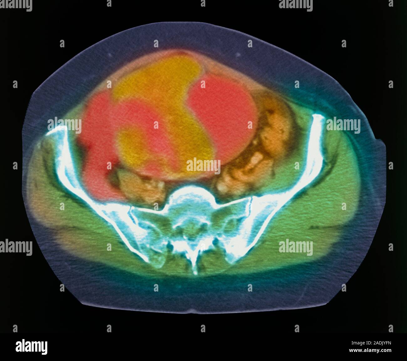 Ovarian Cancer Coloured Magnetic Resonance Imaging Mri Scan Of An Axial Section Through A