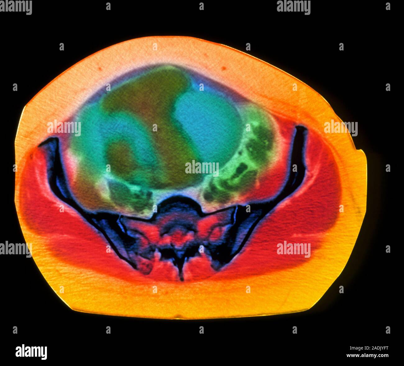 Ovarian cancer. Coloured magnetic resonance imaging (MRI) scan of an ...