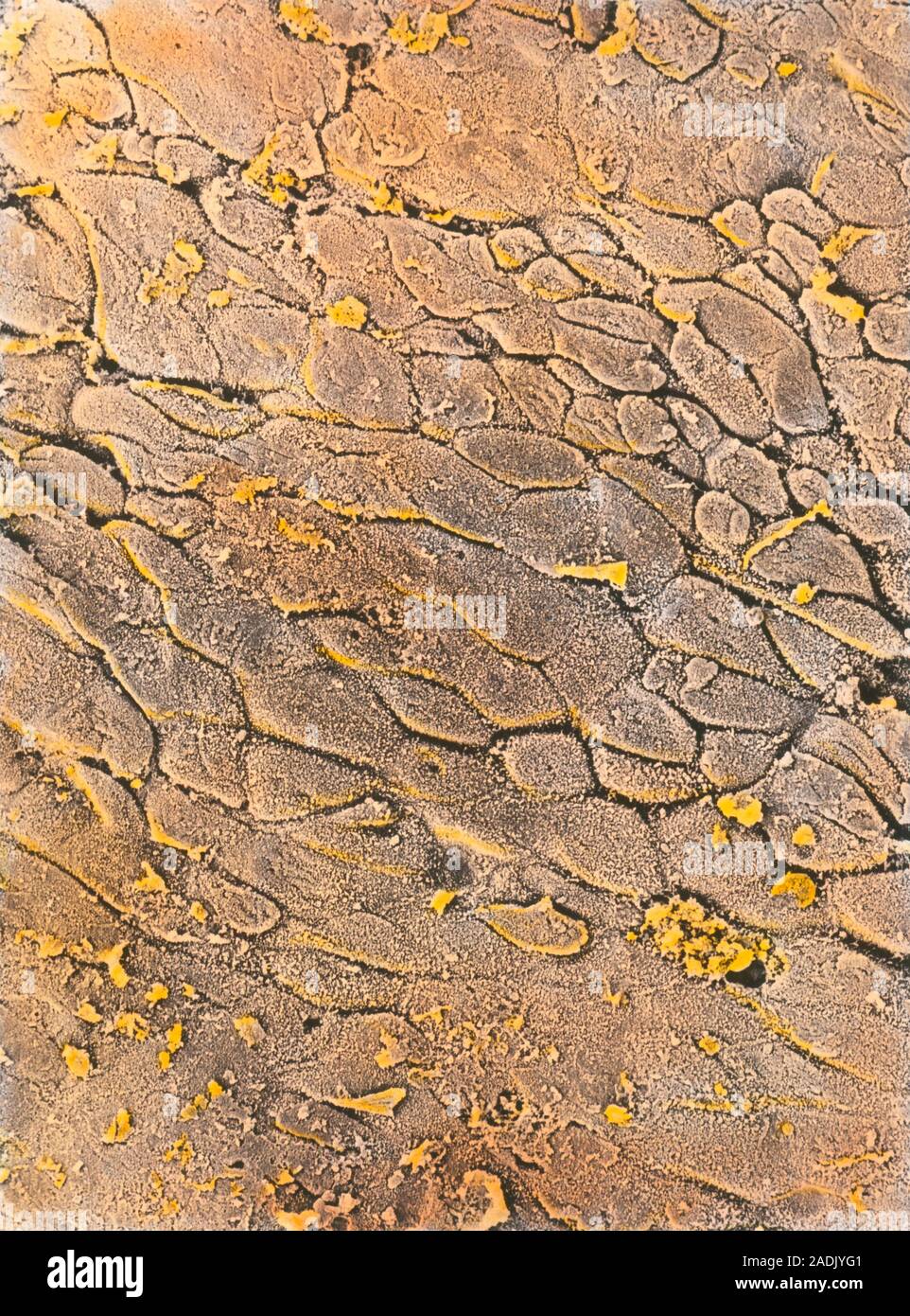 Endometriosis. Coloured scanning electron micro- graph (SEM) of the ...