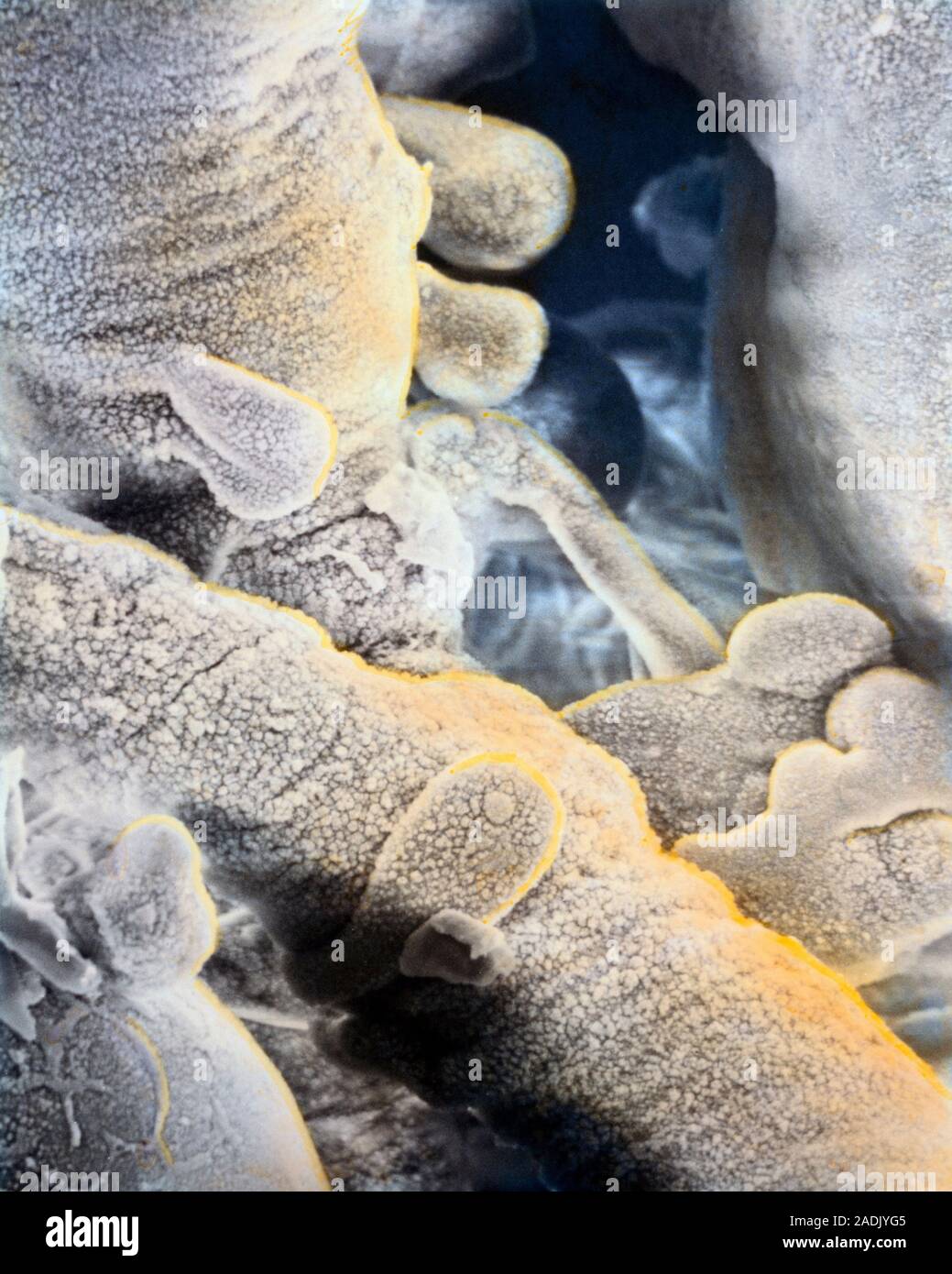 Ectopic pregnancy. Coloured scanning electron micrograph (SEM) of ...