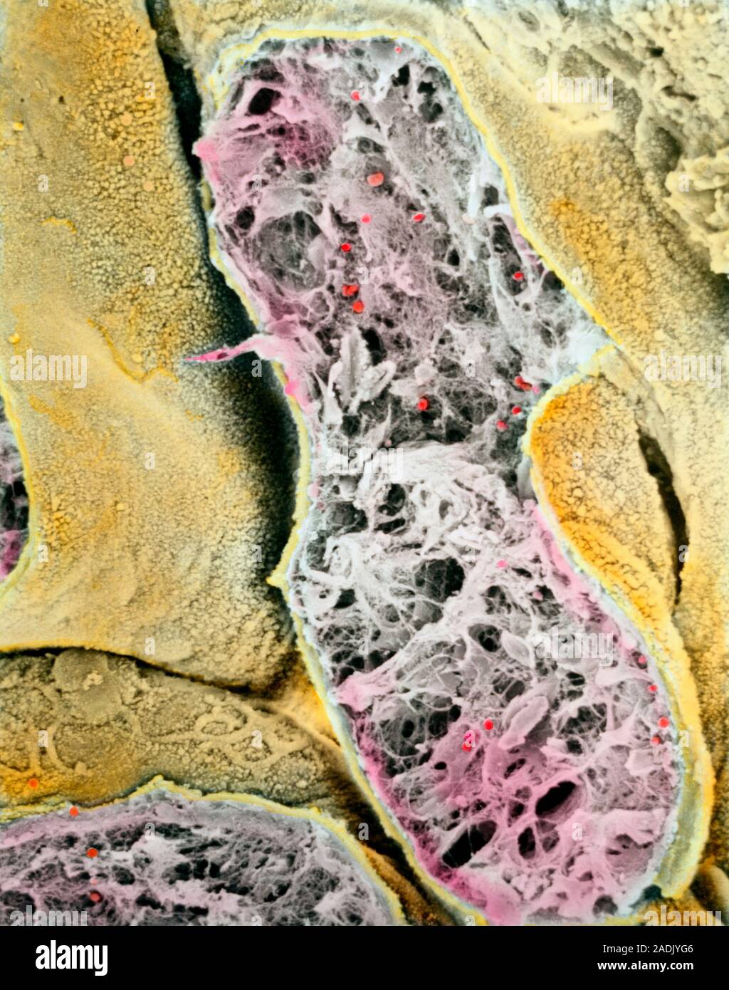 Ectopic pregnancy. Coloured scanning electron micrograph (SEM) of a ...