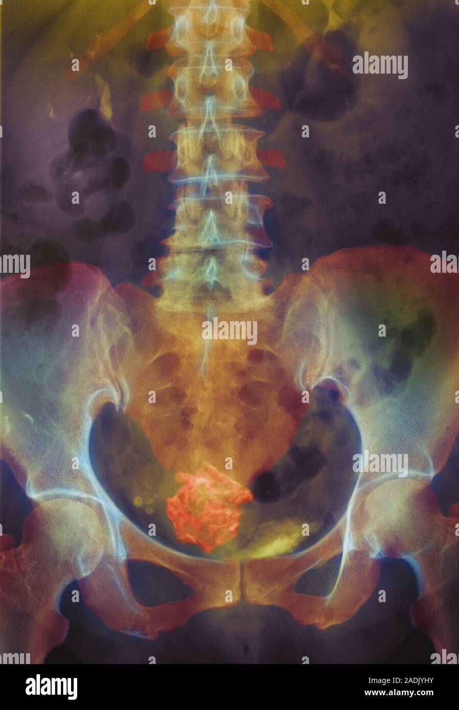 Uterine fibroid. Coloured pelvic X-ray of a 65 year old woman's ...
