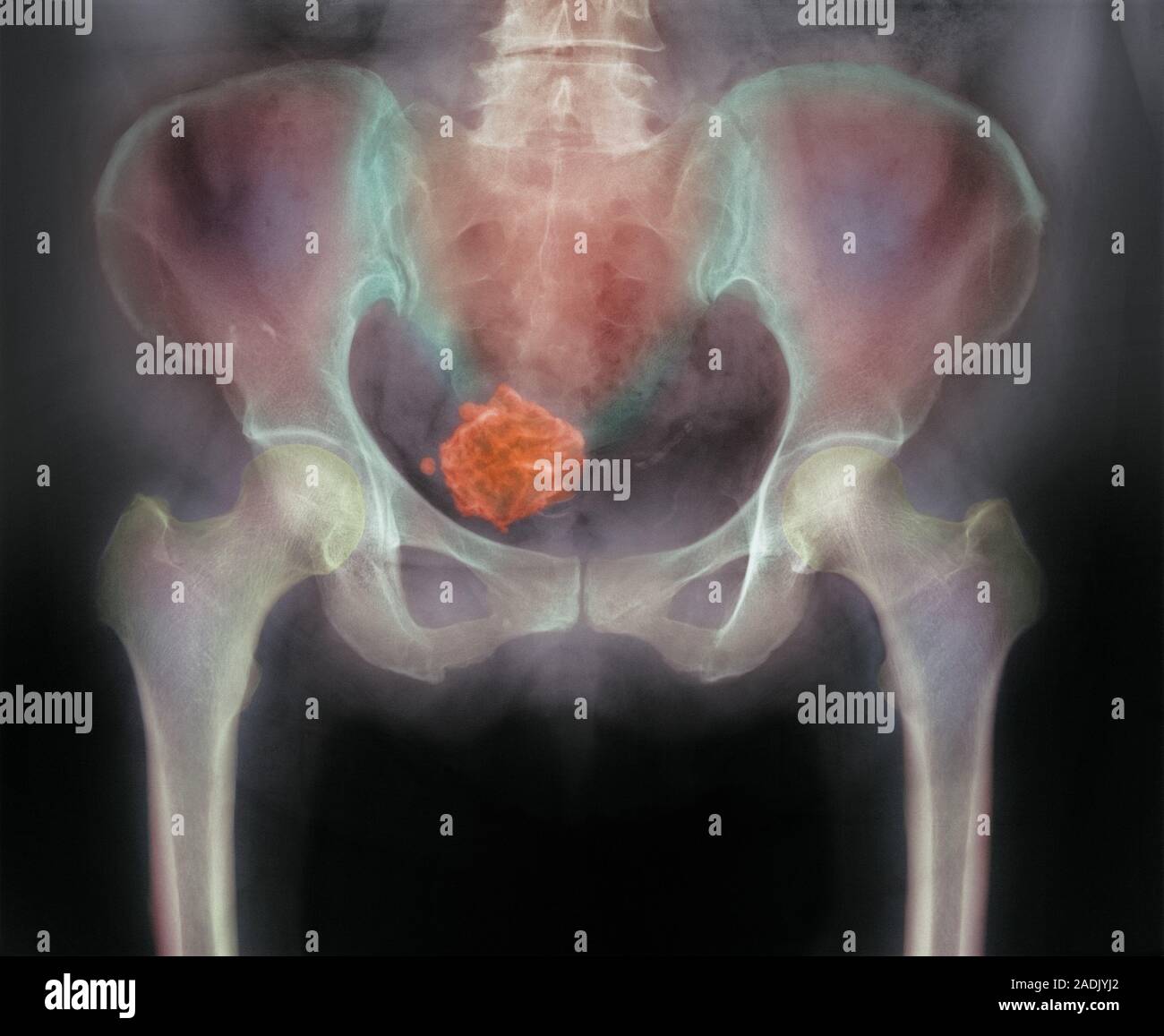 Uterine fibroid. Coloured pelvic X-ray of a 65 year old woman's ...