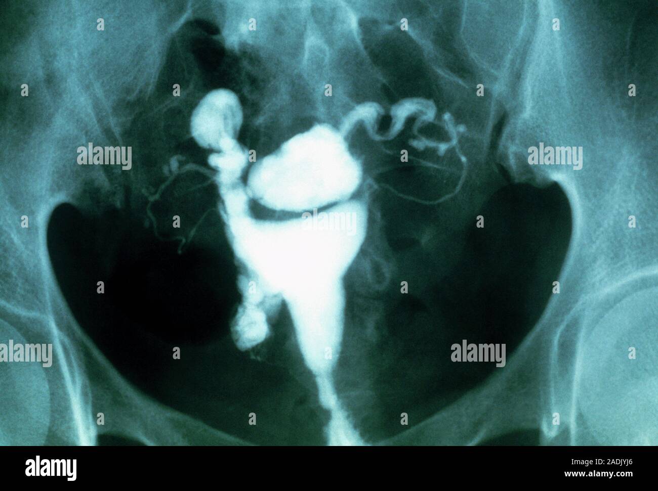 Endometriosis. X-ray of a woman's abdomen showing swollen Fallopian ...