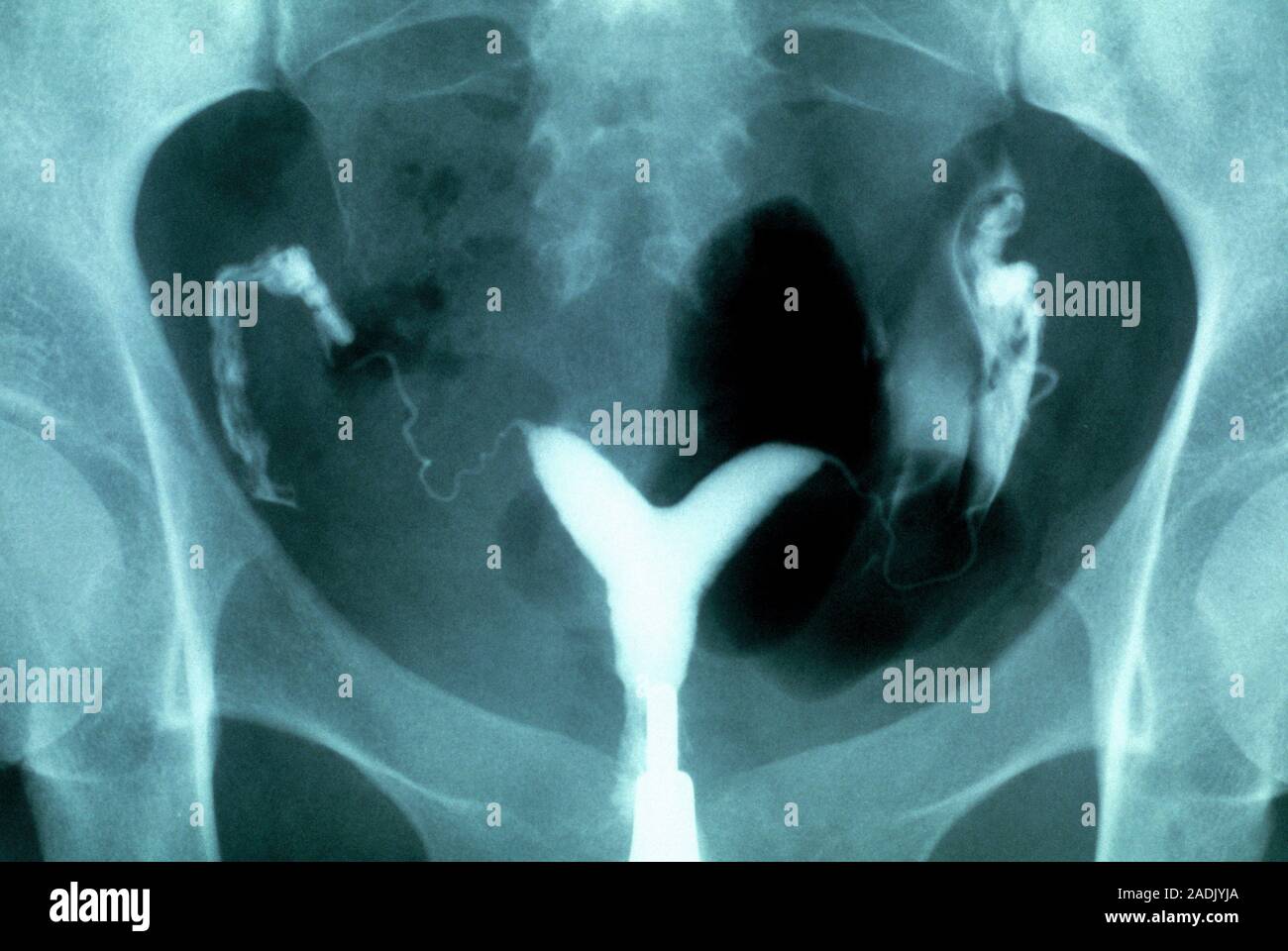 Two-horned uterus. X-ray of the abdomen of a woman showing her two ...