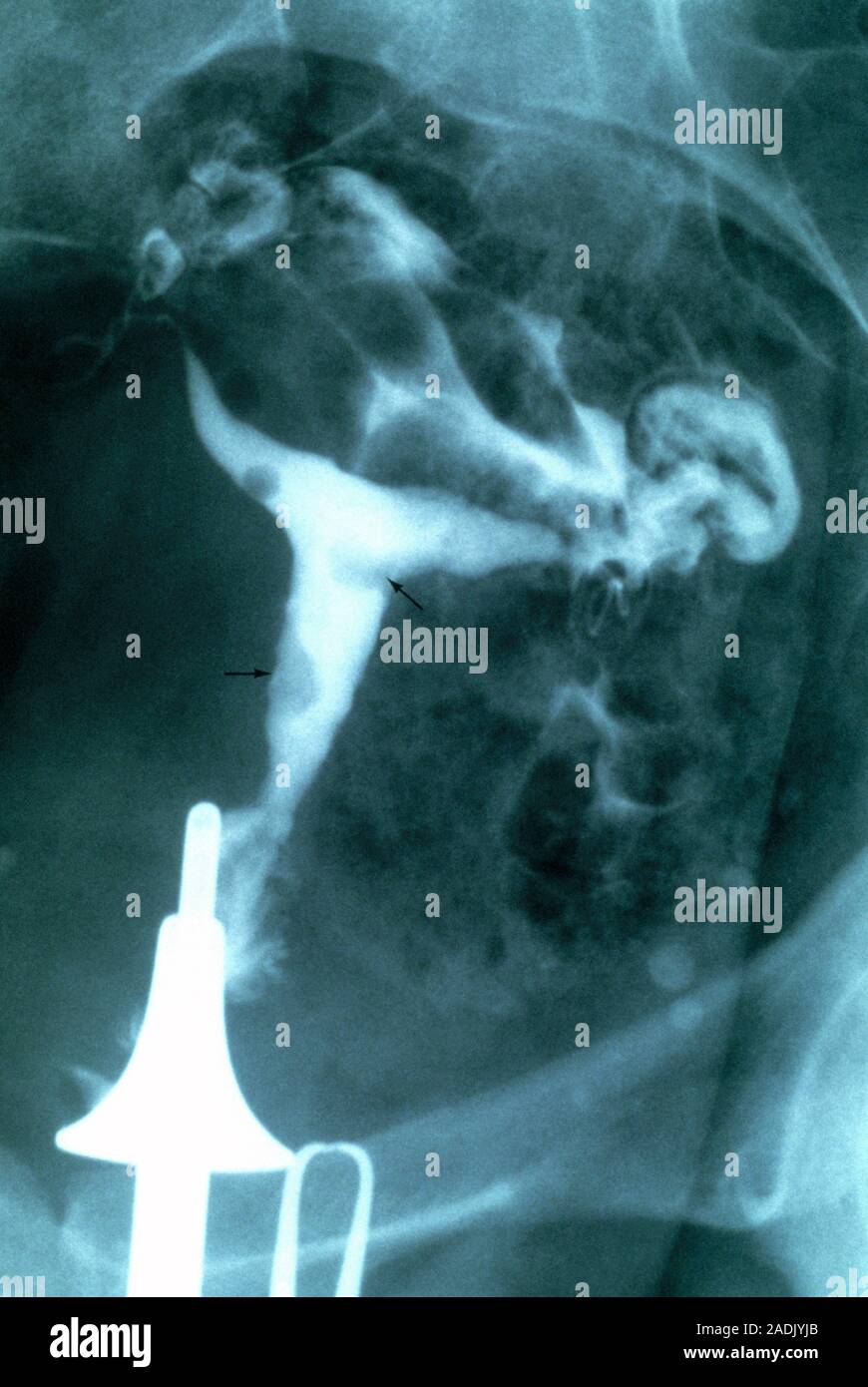 Uterine polyps. Abdominal X-ray of uterine polyps (light grey, arrowed ...