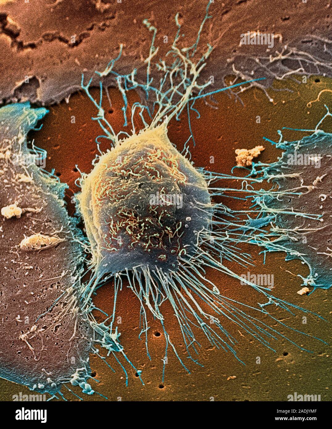 Cervical cancer cell. Coloured scanning electron micrograph (SEM) of a ... Cervical cancer cell. Coloured scanning electron micrograph (SEM) of a ...