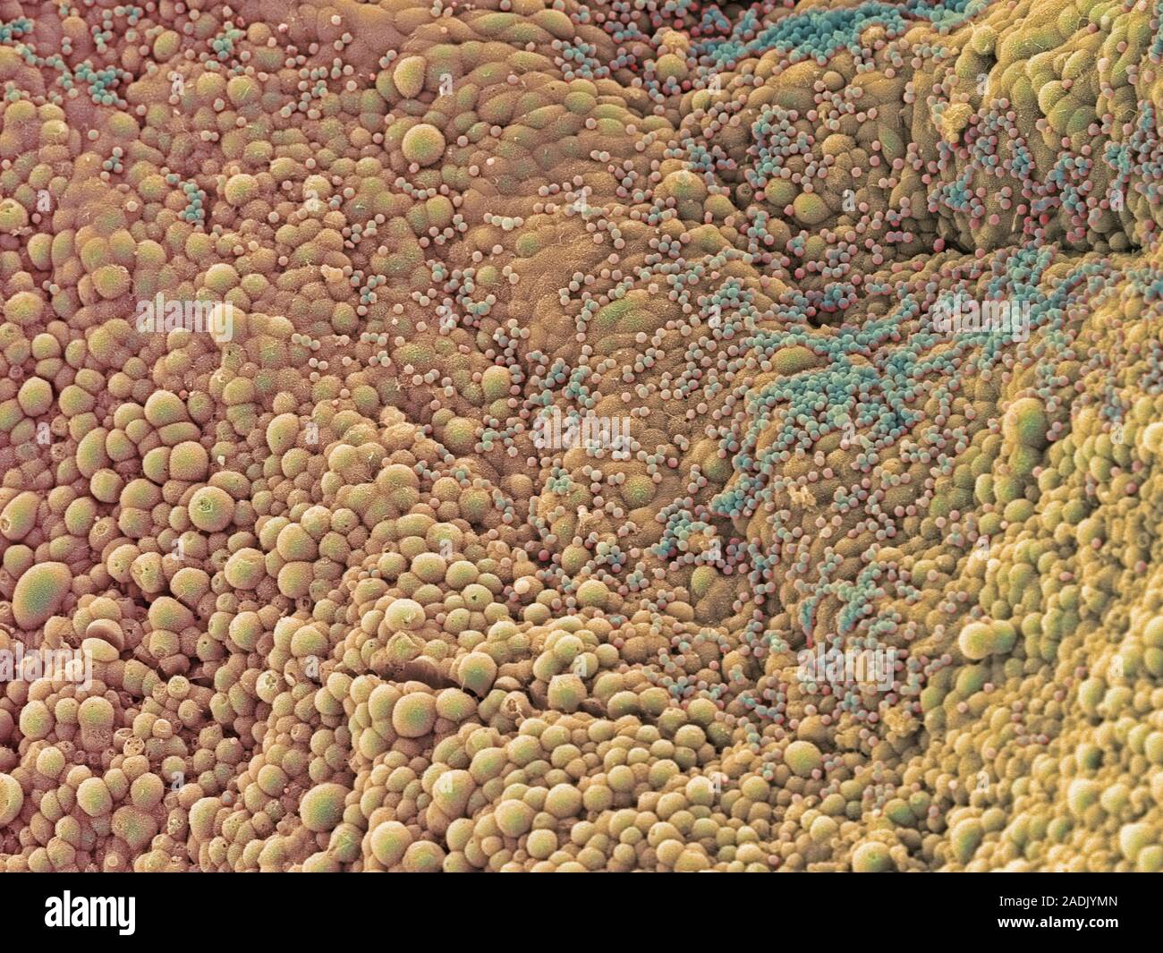 Ovarian cyst lining. Coloured scanning electron micrograph (SEM) of ...