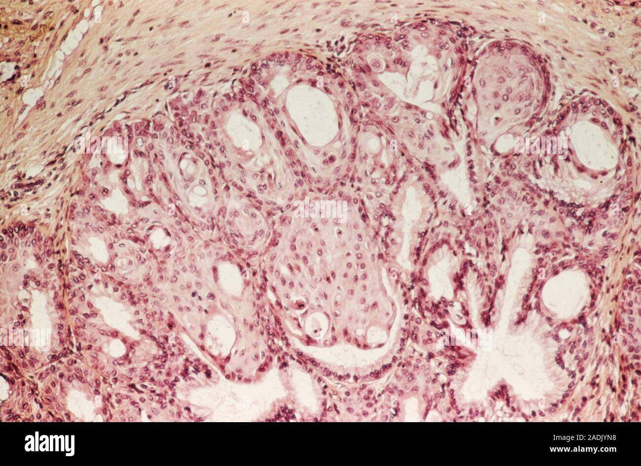 Cervix tumours. Light micrograph of a section through the neck (cervix ...