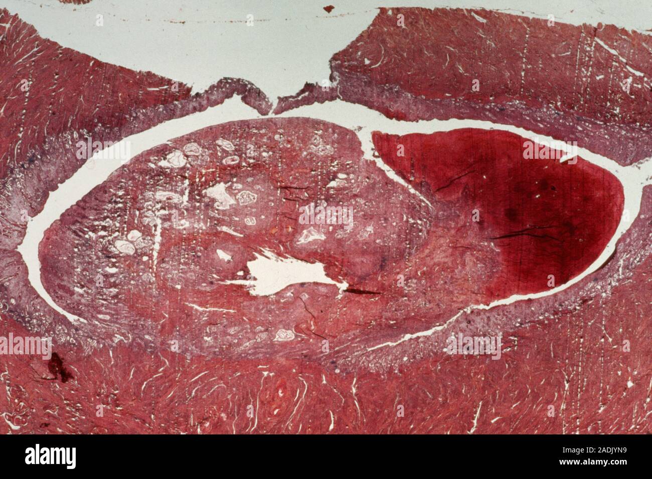 Uterine polyp. Light micrograph of a section through a polyp (centre ...