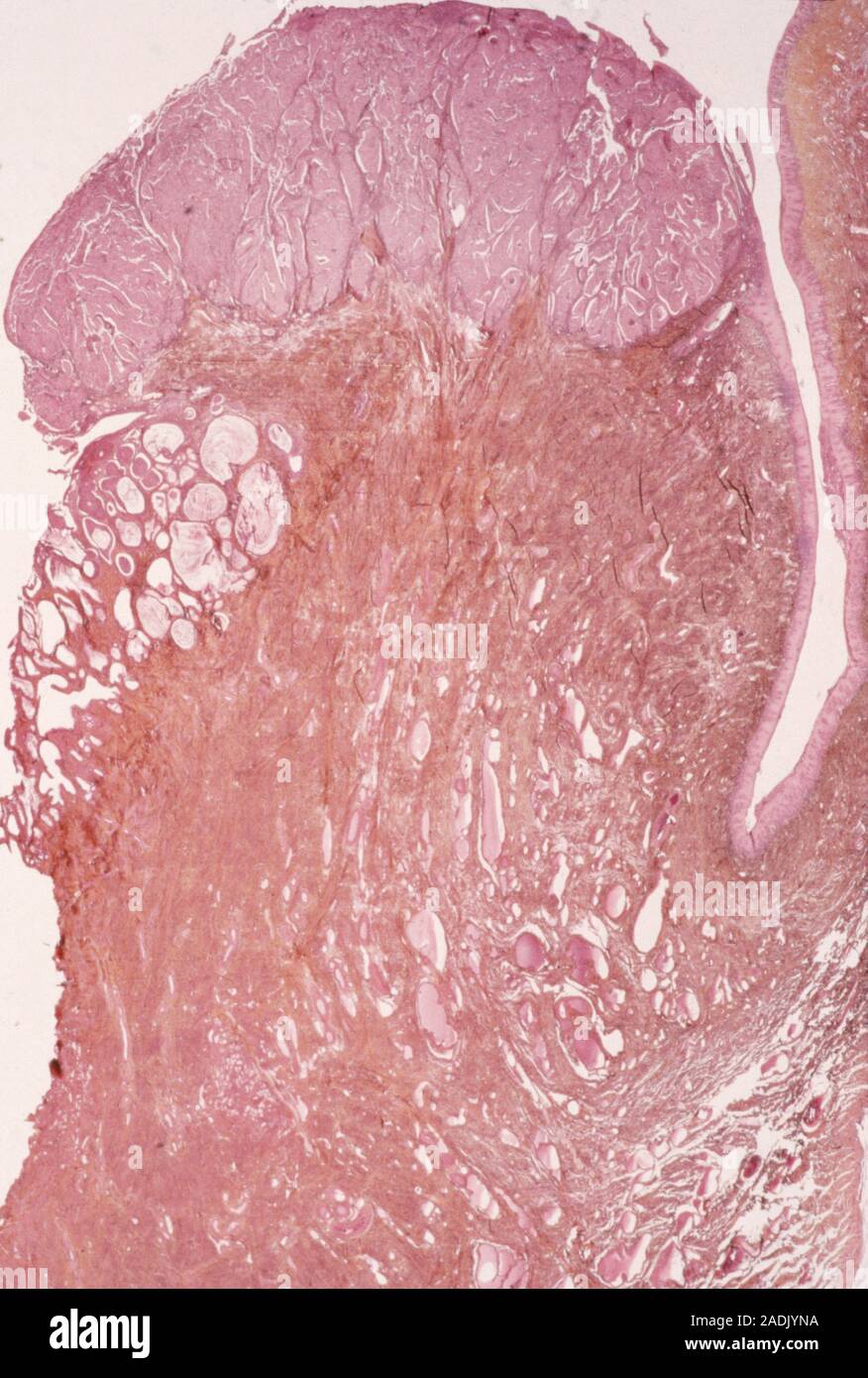 Cervical cancer. Light micrograph through a section of a cervix ...