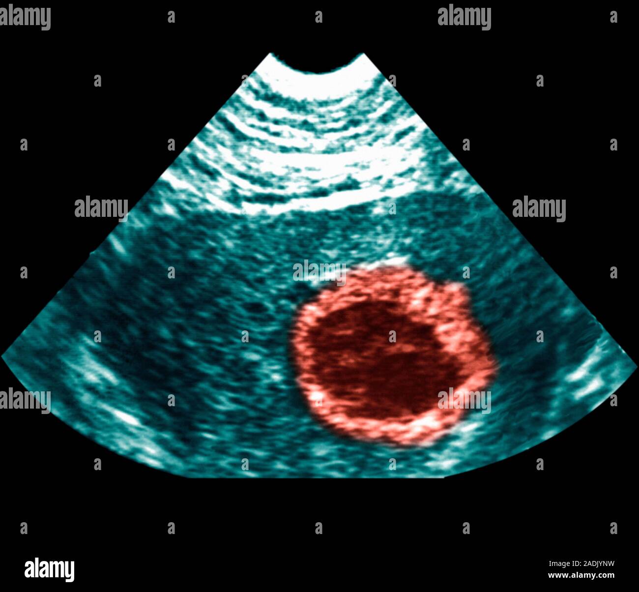 Unplanned pregnancy, coloured ultrasound scan. The pregnancy developed ...