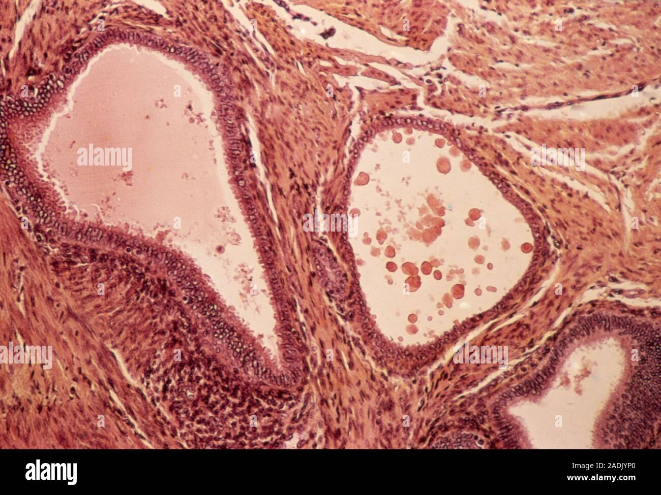 Endometriosis. Light micrograph of a section through the uterus wall ...