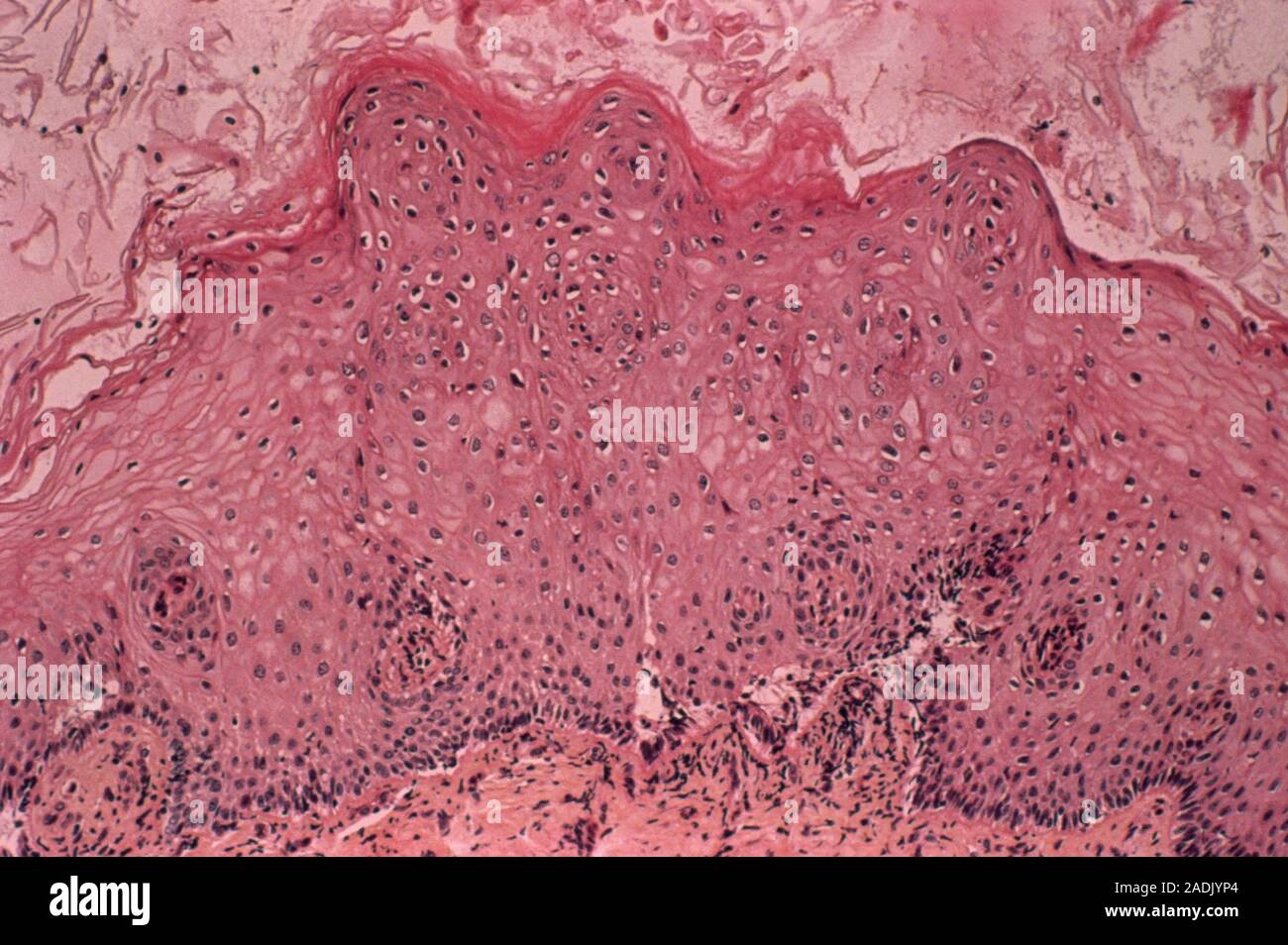 Cervical wart. Light micrograph of a section through a condyloma ...