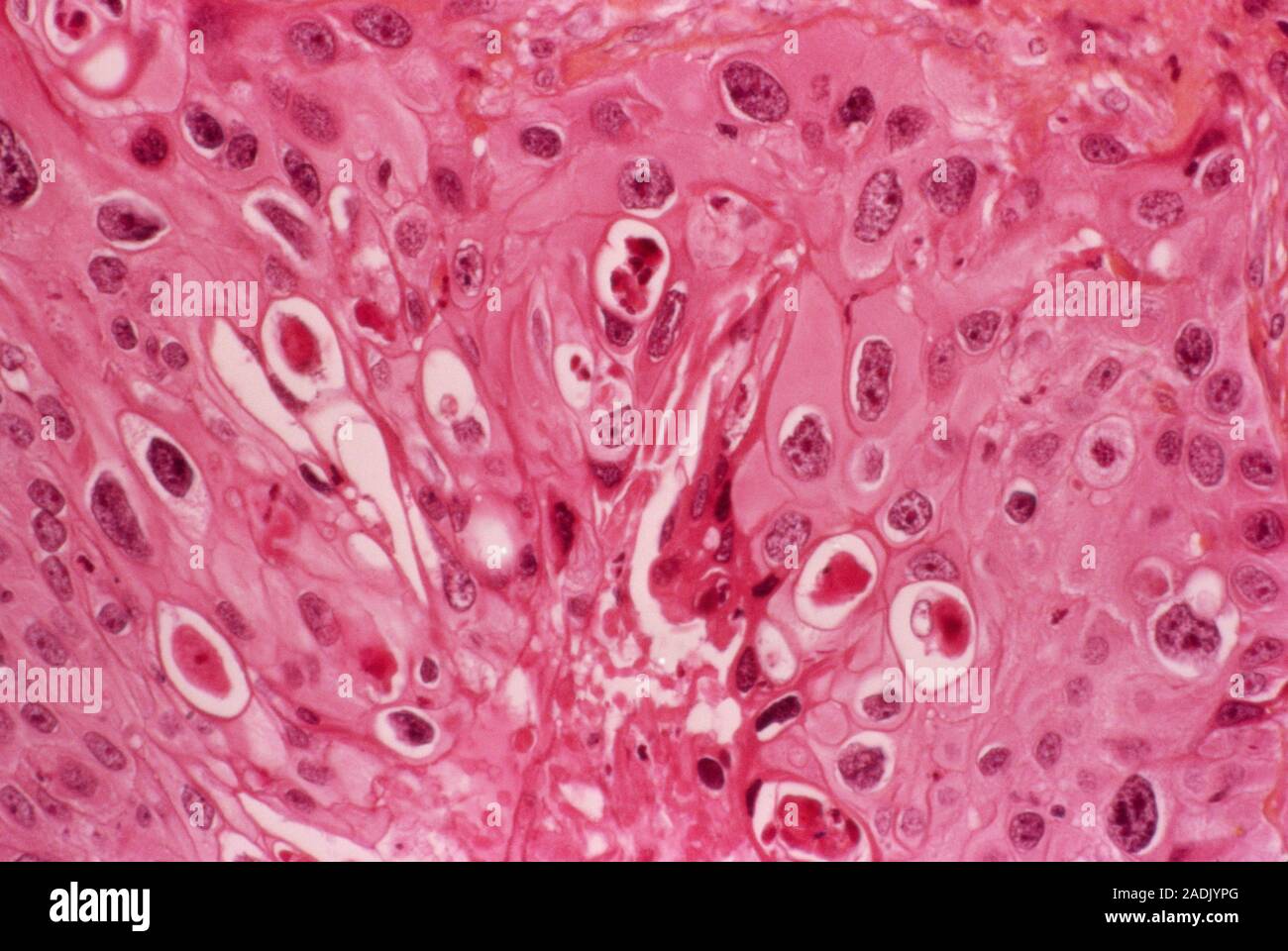 Cervical cancer. Light micrograph through a squamous cell (or ...
