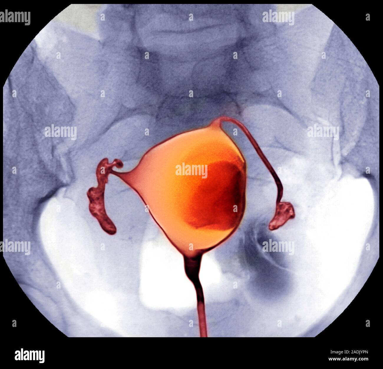 Uterine fibroid, coloured X-ray. Injection of a contrast medium (red ...