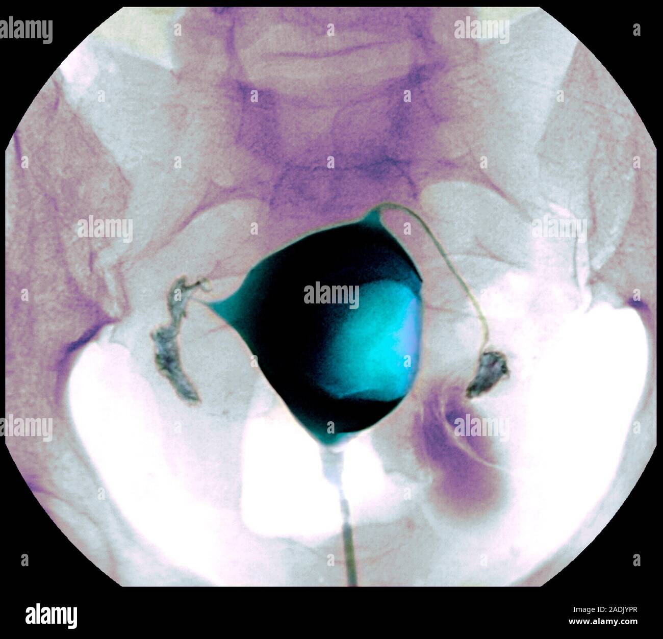Uterine fibroid, coloured X-ray. Injection of a contrast medium (dark ...