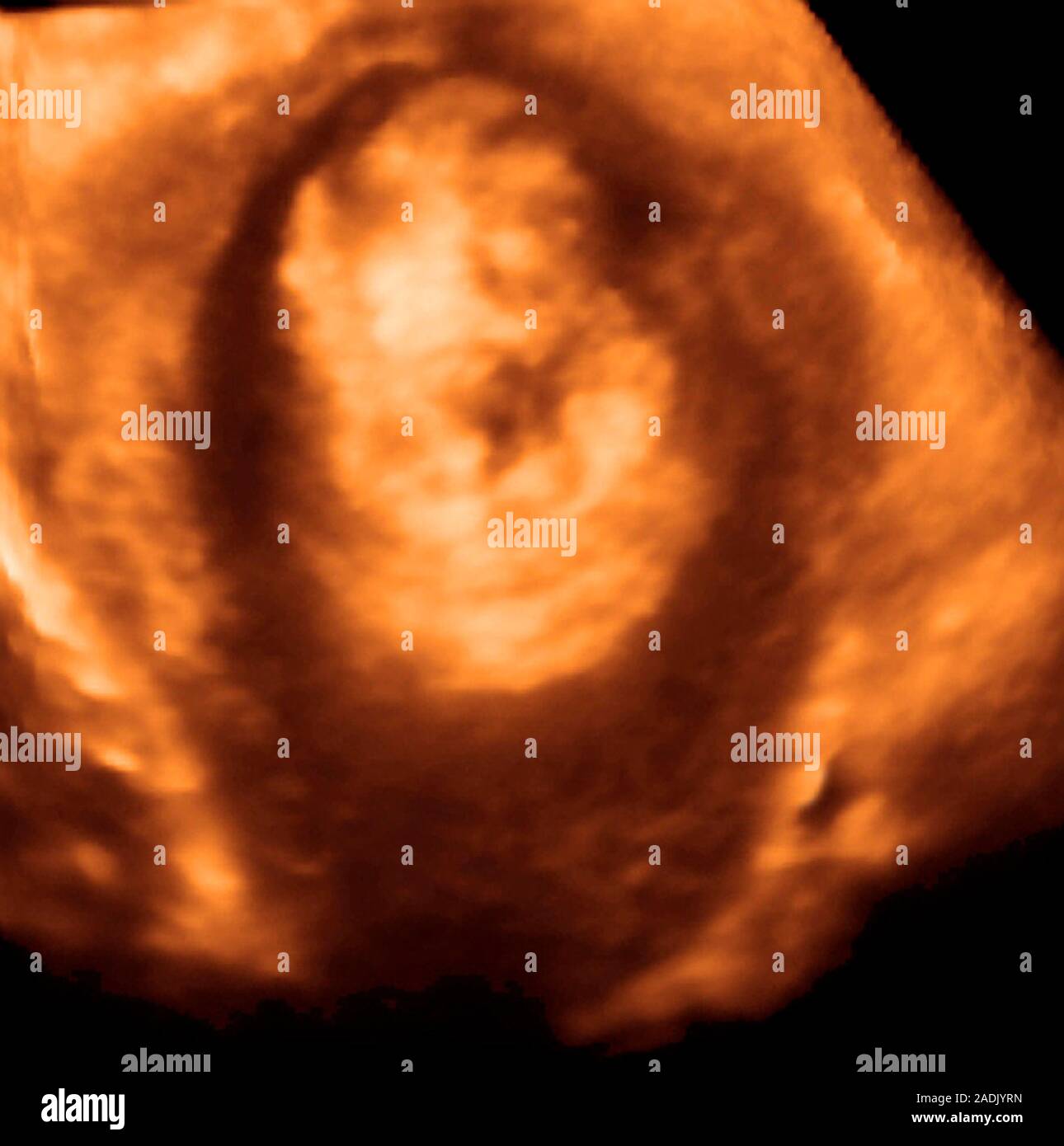 Uterine fibroid. Coloured 3-D ultrasound scan of a submucous fibroid ...