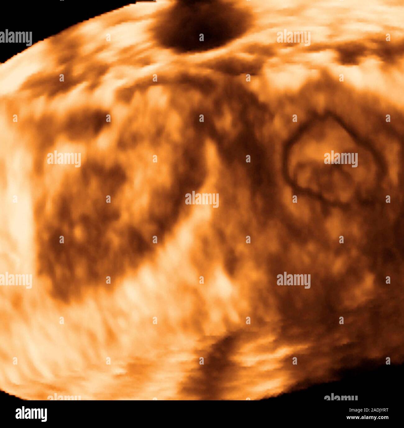 Ectopic pregnancy. Coloured 3-D ultrasound scan of a 7-week-old ectopic ...
