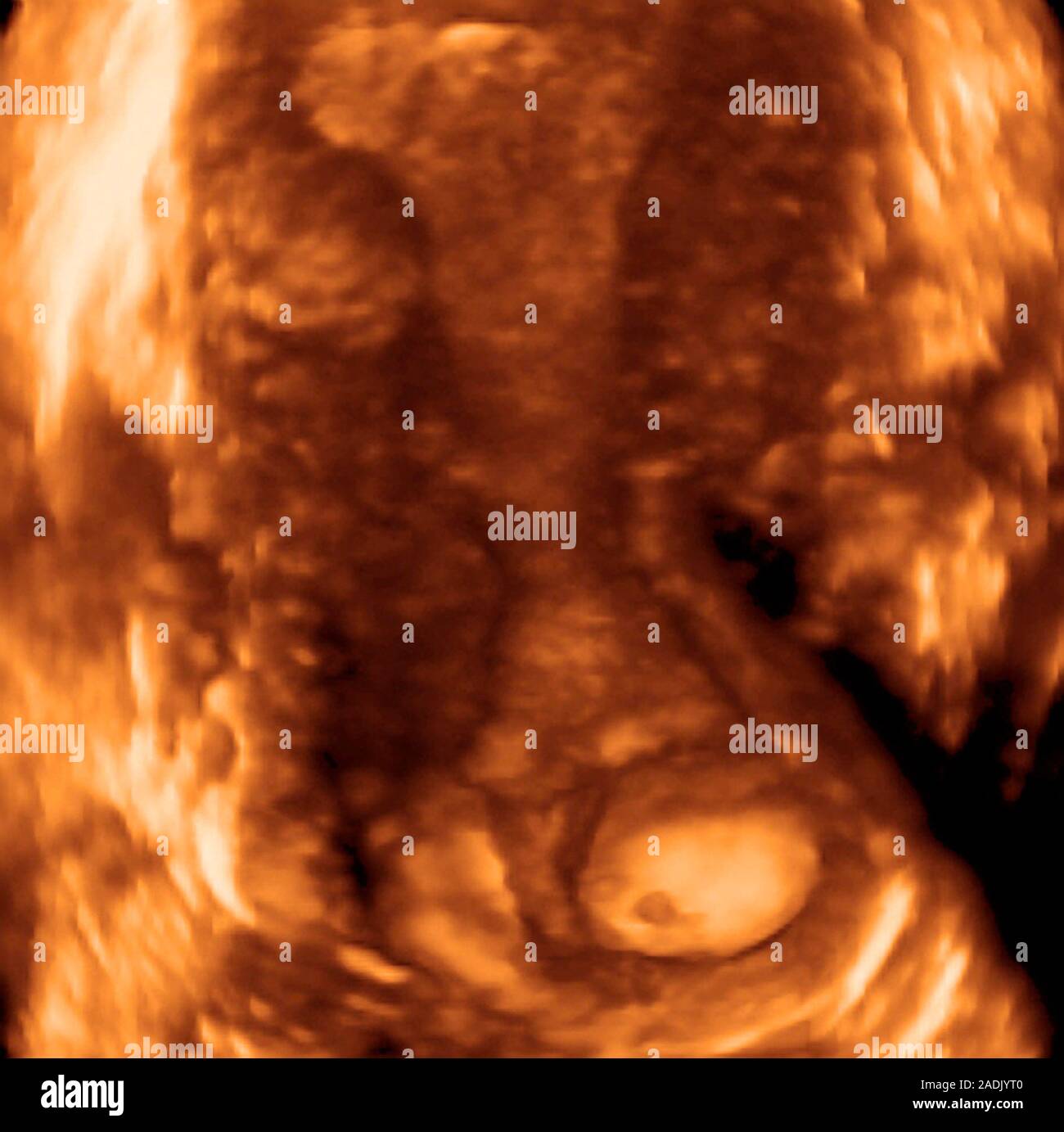 Cervical cyst. Coloured 3-D ultrasound scan of a mucous cyst (pale oval ...